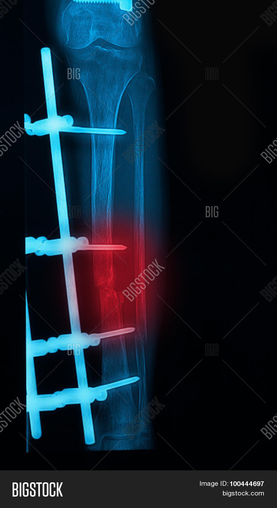 Leg X-rays Image Image & Photo (Free Trial) | Bigstock