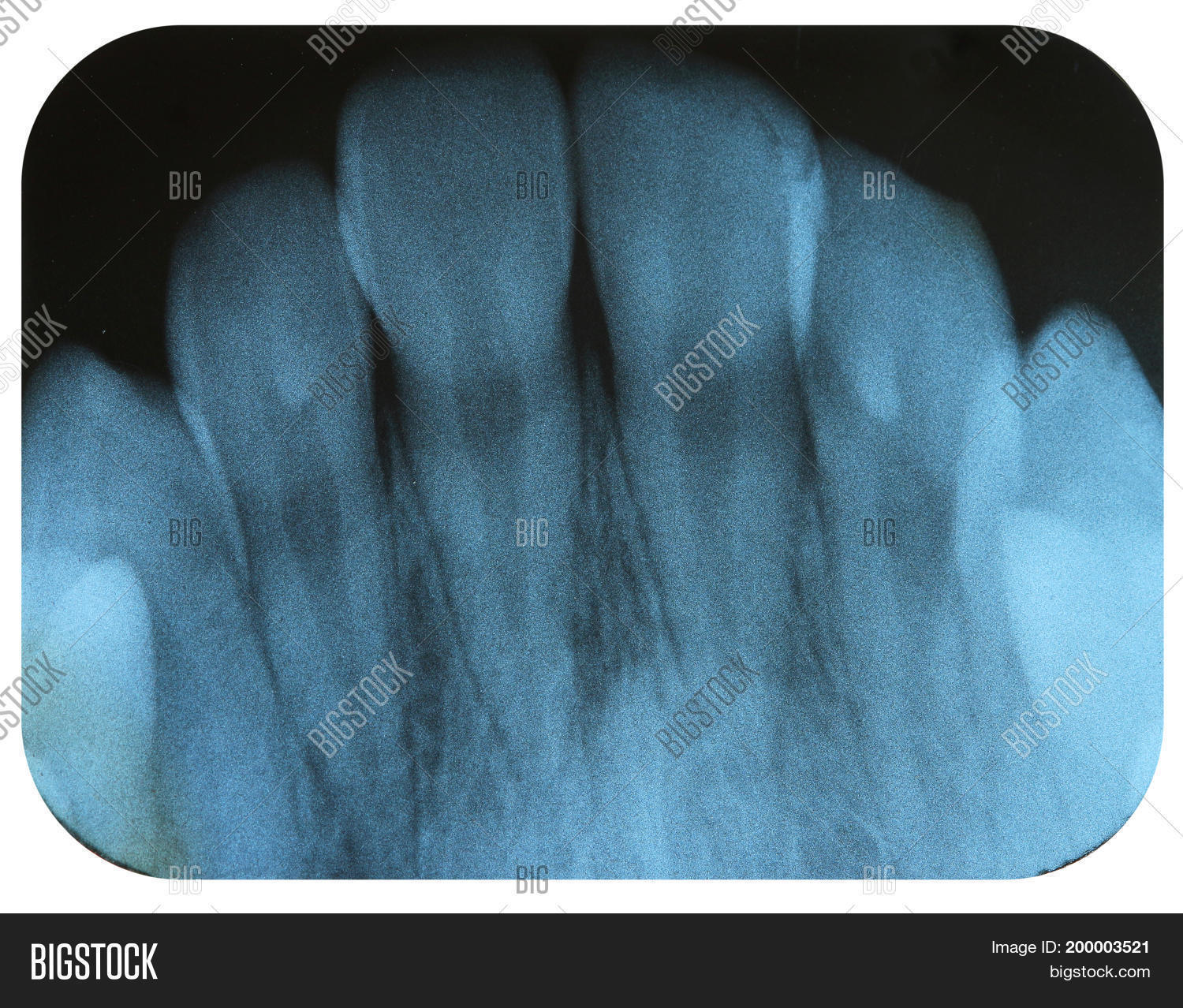 X-Ray Negative Healthy Image & Photo (Free Trial) | Bigstock
