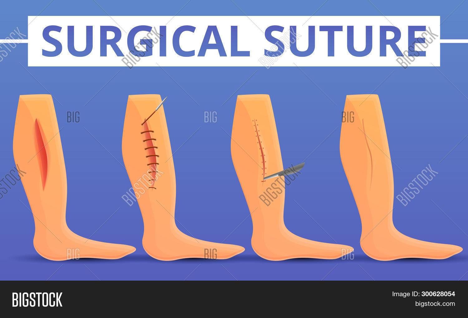 Medical Suture Concept Image & Photo (Free Trial) | Bigstock