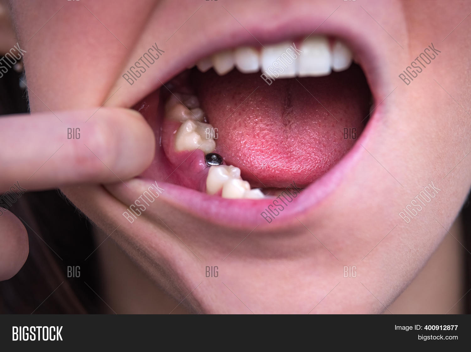 Single Tooth Implant. Image & Photo (Free Trial) | Bigstock