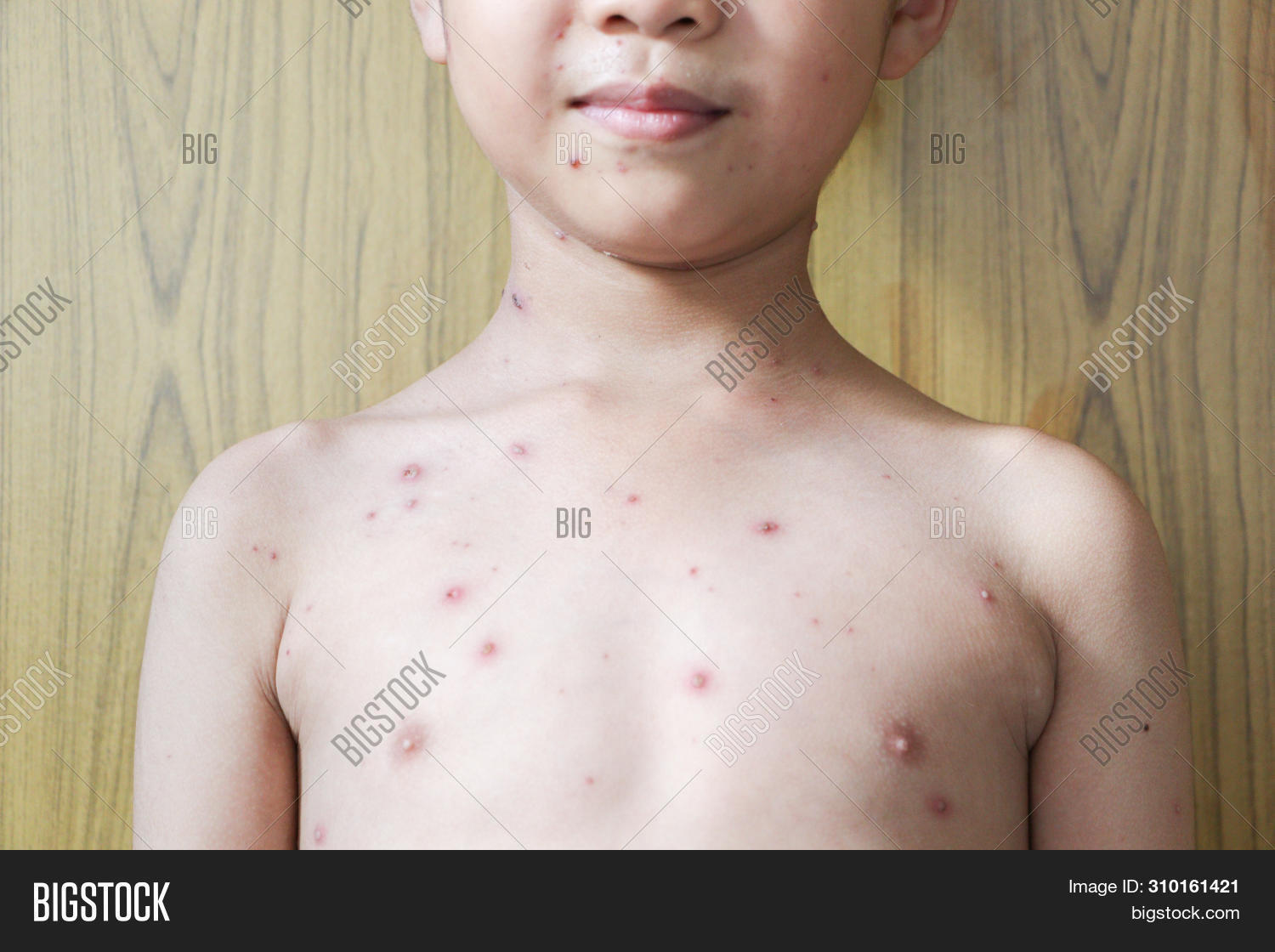 Chicken Pox Rash On Image & Photo (Free Trial) | Bigstock