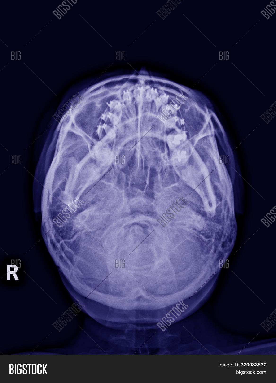 Film Mandible Showed Image & Photo (Free Trial) | Bigstock