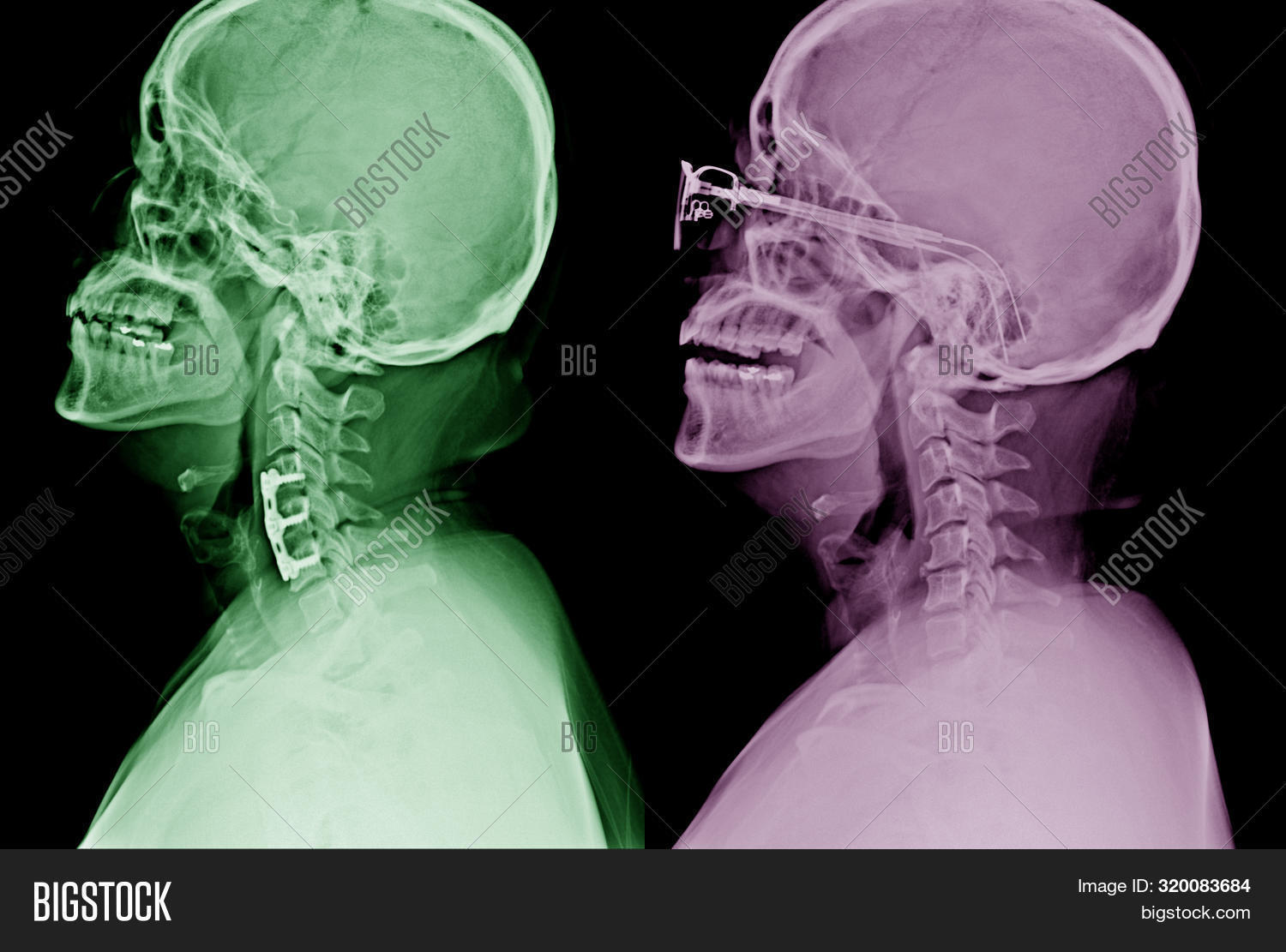 Pacemaker X-ray Image Image & Photo (Free Trial) | Bigstock