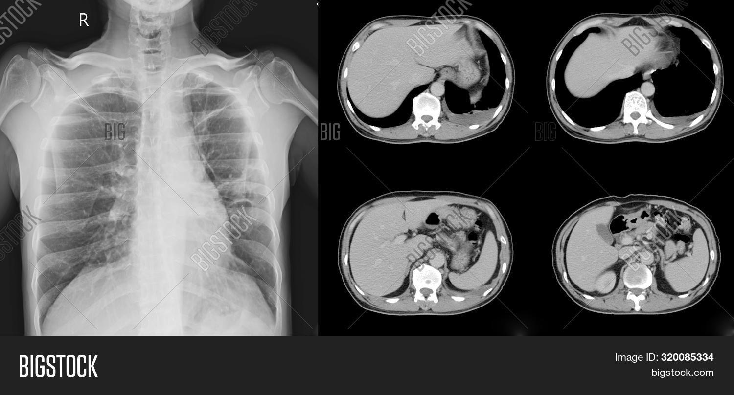 Chest X-ray Ct Chest Image & Photo (Free Trial) | Bigstock