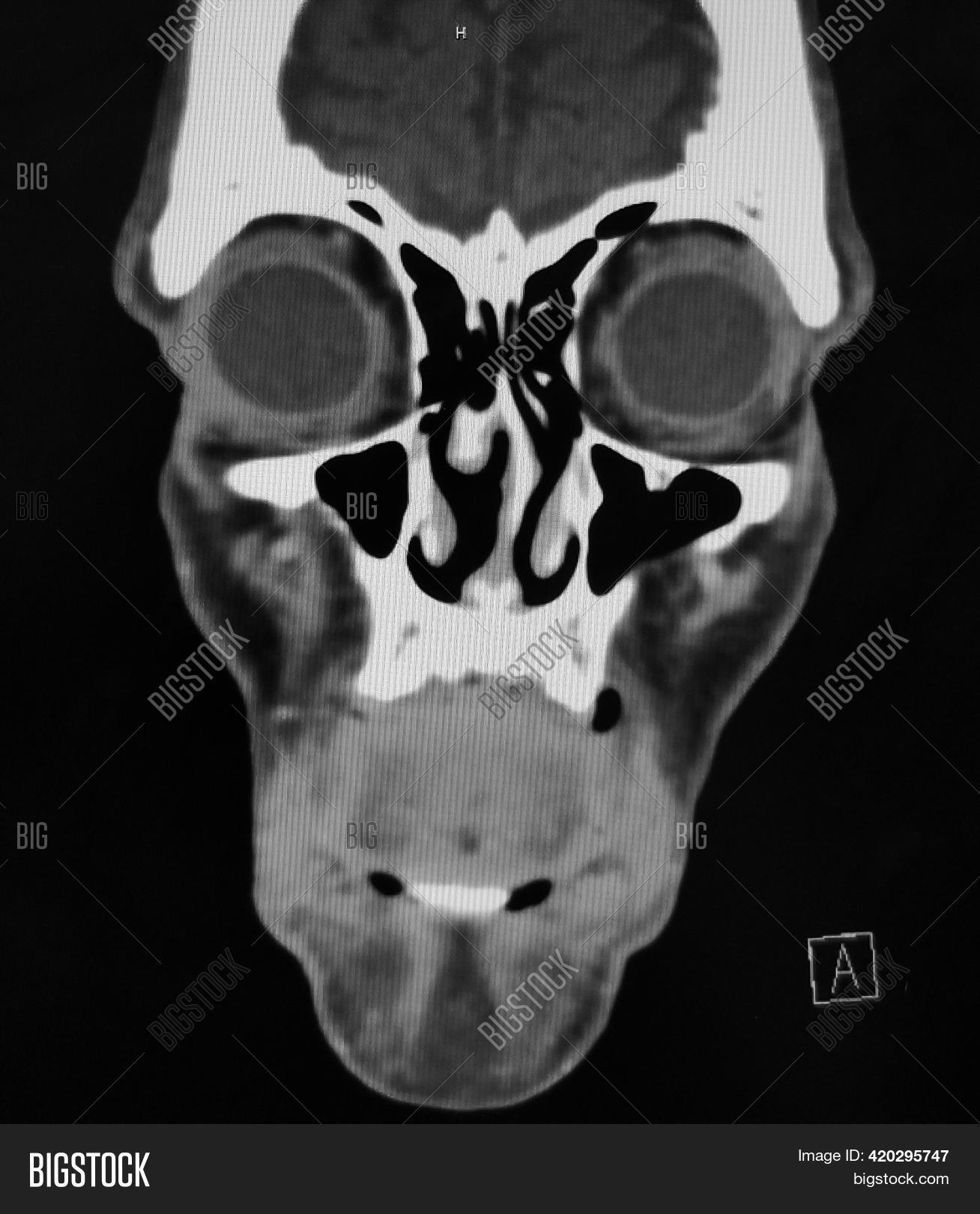 Coronal Ct Scan Image & Photo (Free Trial) | Bigstock