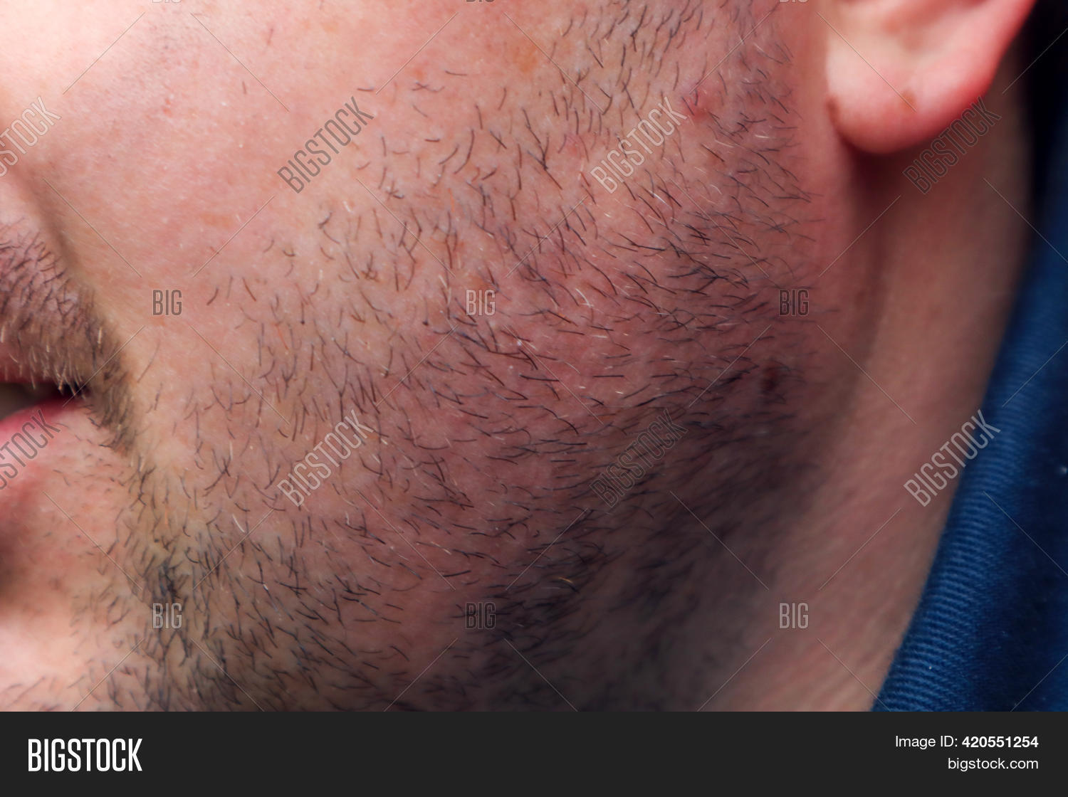 Pigmentation Spots On Image & Photo (Free Trial) | Bigstock