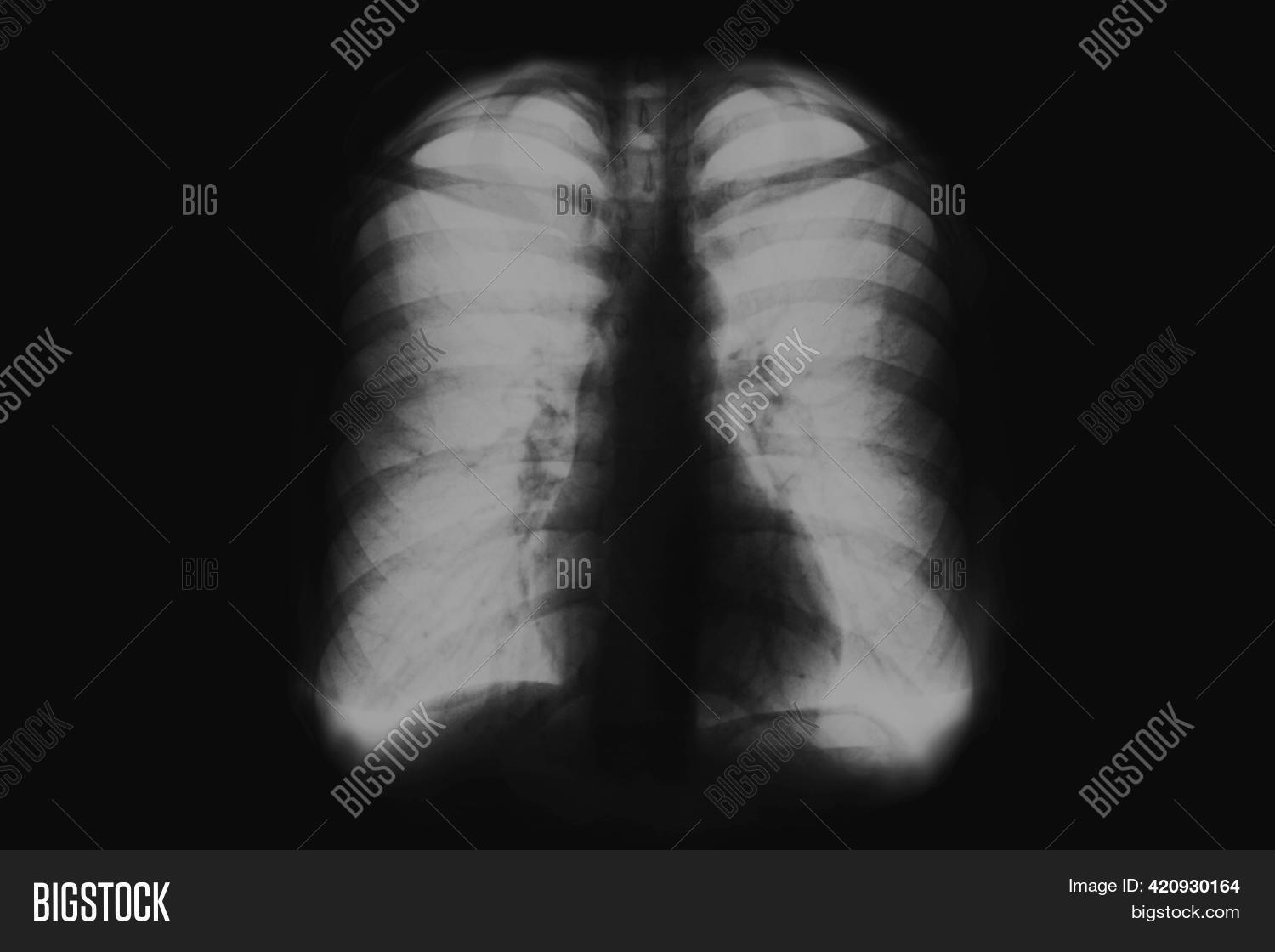 X-ray Film Human Chest Image & Photo (Free Trial) | Bigstock