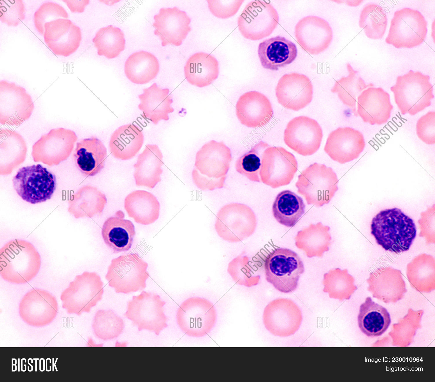 Erythroblastosis Image & Photo (Free Trial) | Bigstock
