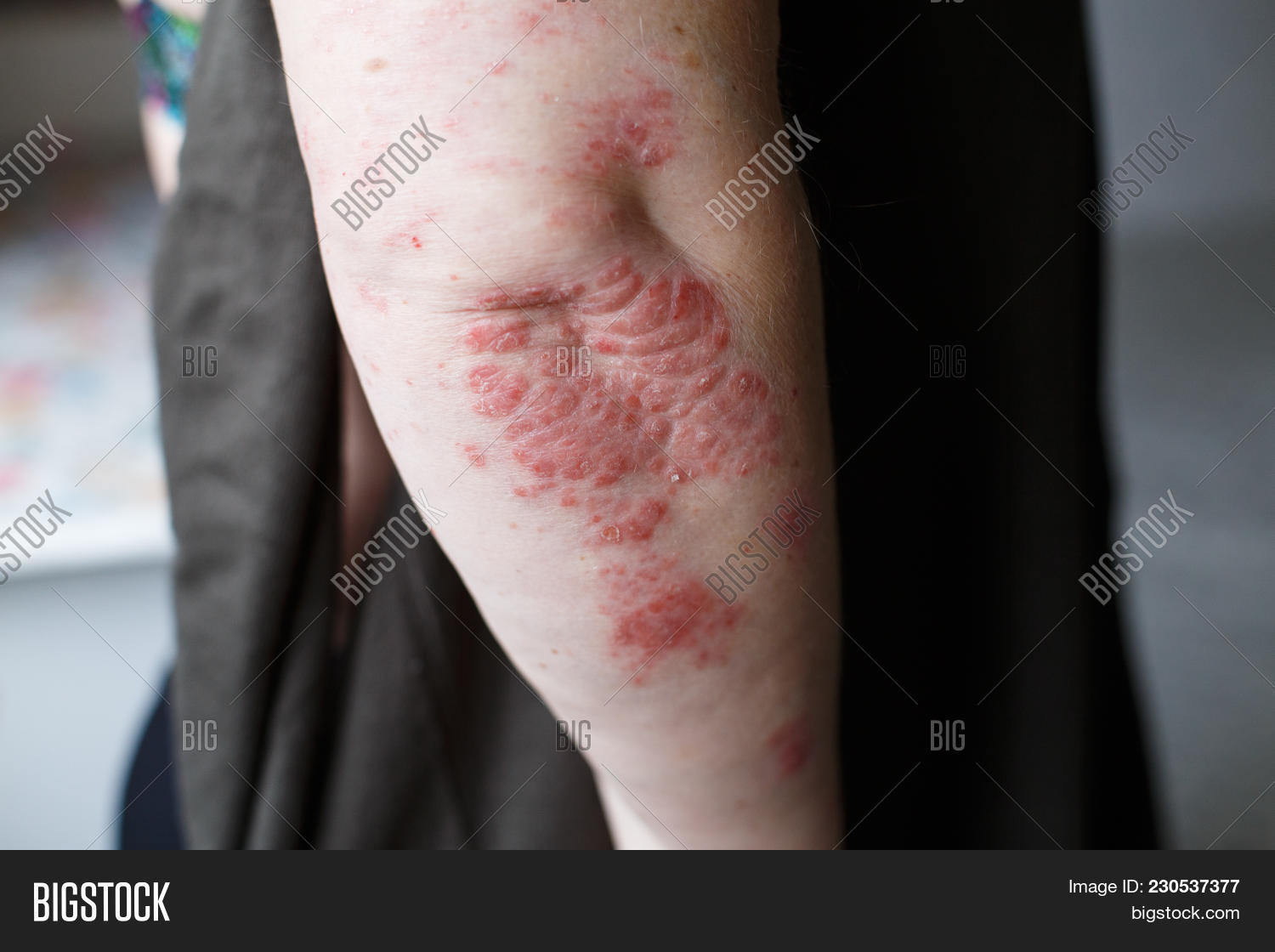 Psoriasis Skin. Image & Photo (Free Trial) | Bigstock