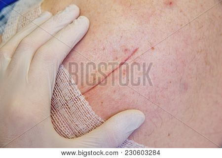 Fresh Scar After Image & Photo (Free Trial) | Bigstock