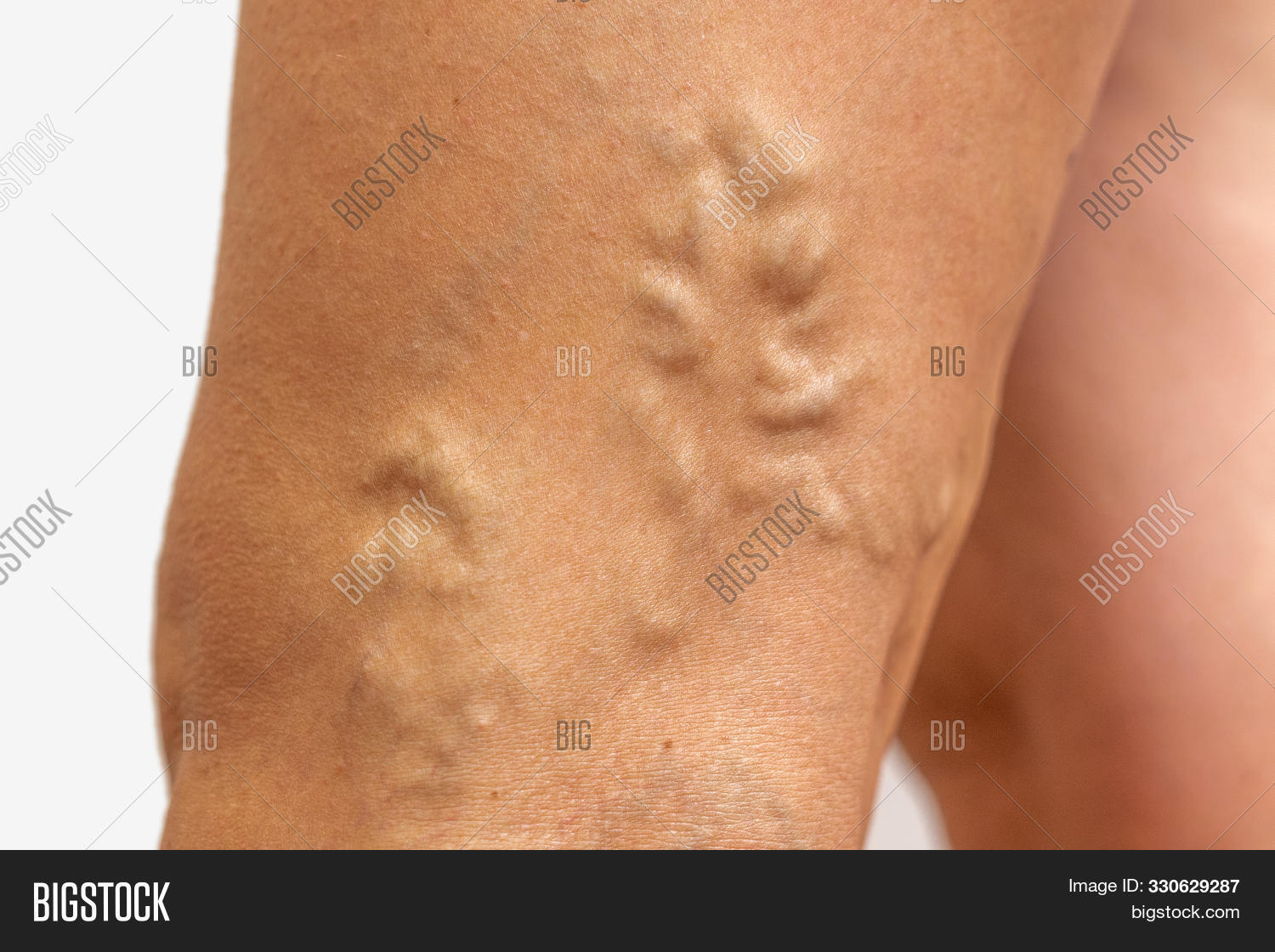 Varicose Veins On Skin Image & Photo (Free Trial) | Bigstock