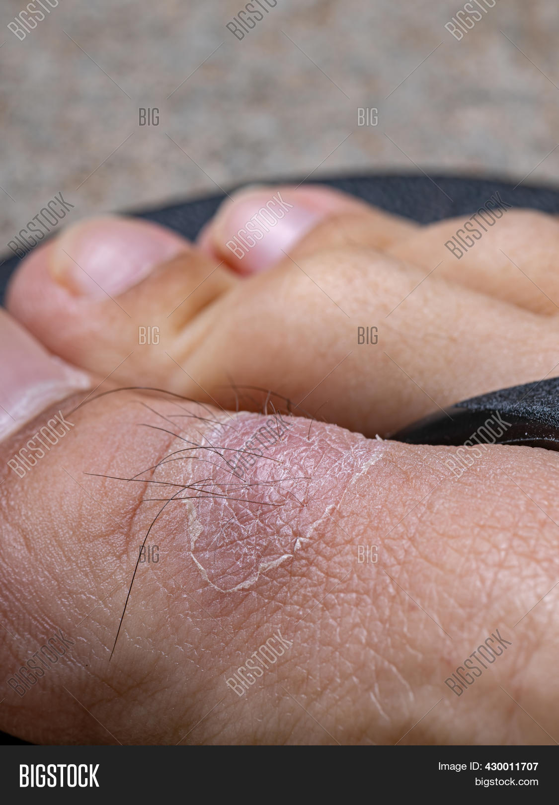 Healing Process Skin Image And Photo Free Trial Bigstock