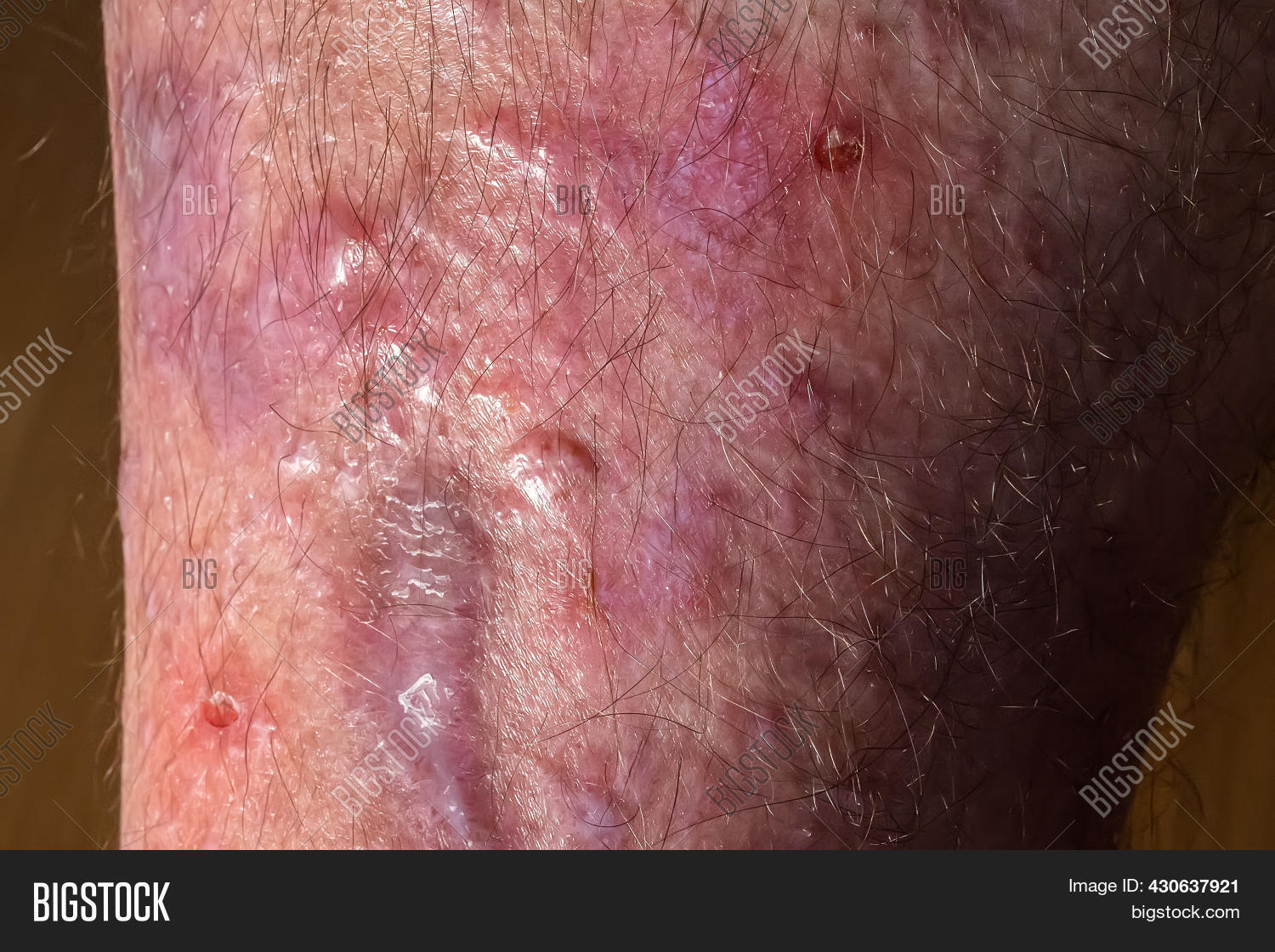 Spots Lichen Planus On Image & Photo (Free Trial) | Bigstock