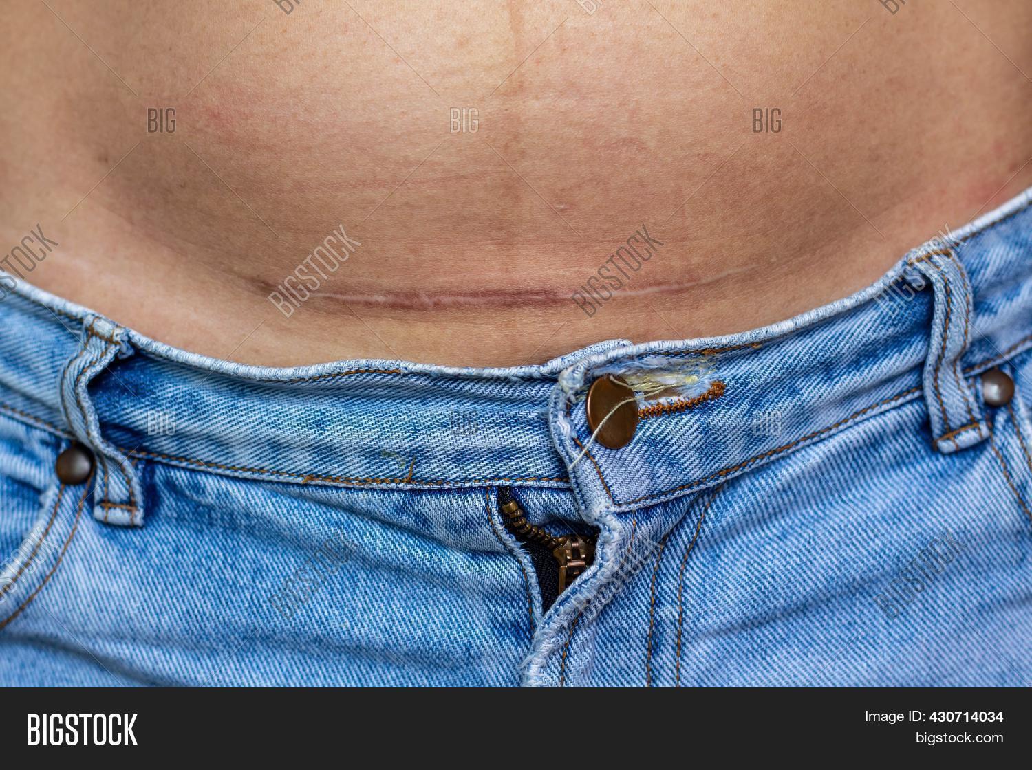 Scar On Abdomen Woman Image & Photo (Free Trial) | Bigstock
