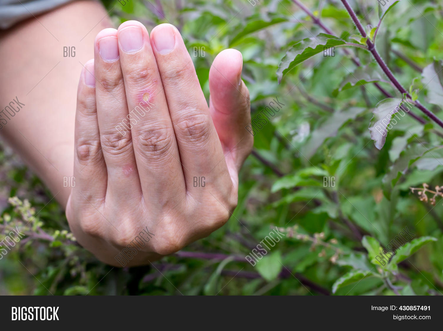 Paronychia, Swollen Image & Photo (Free Trial) | Bigstock