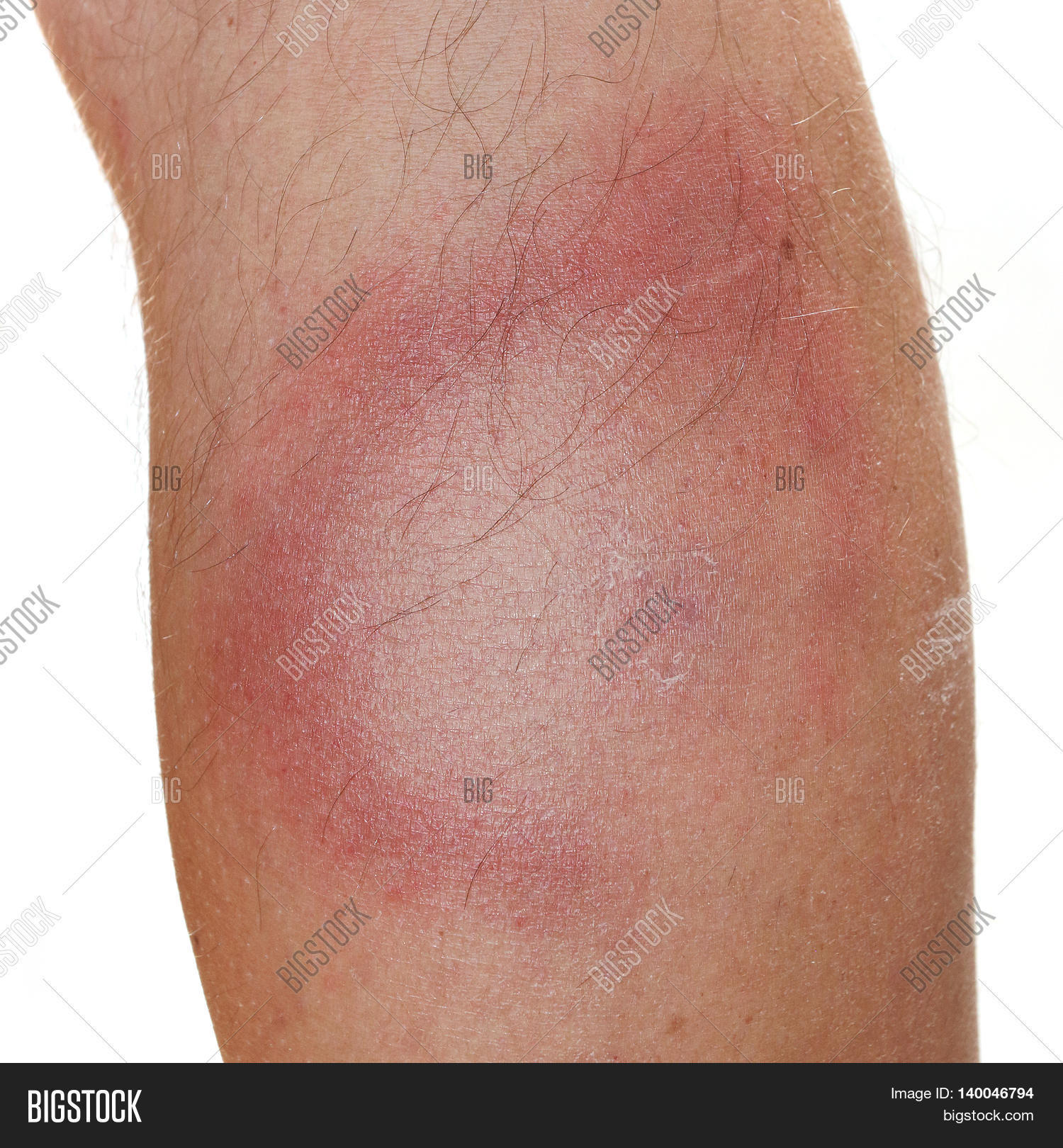 Erythema Migrans Rash Image & Photo (Free Trial) | Bigstock