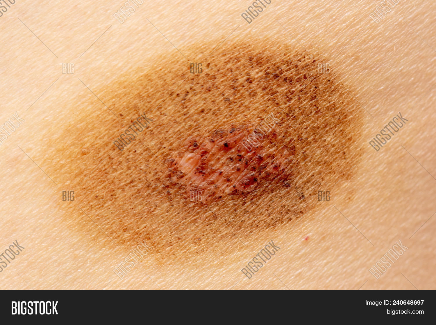 Ringworm On Human Skin Image & Photo (Free Trial) | Bigstock