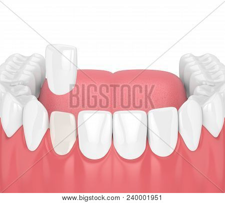 3D Render Teeth Veneer Image & Photo (Free Trial) | Bigstock