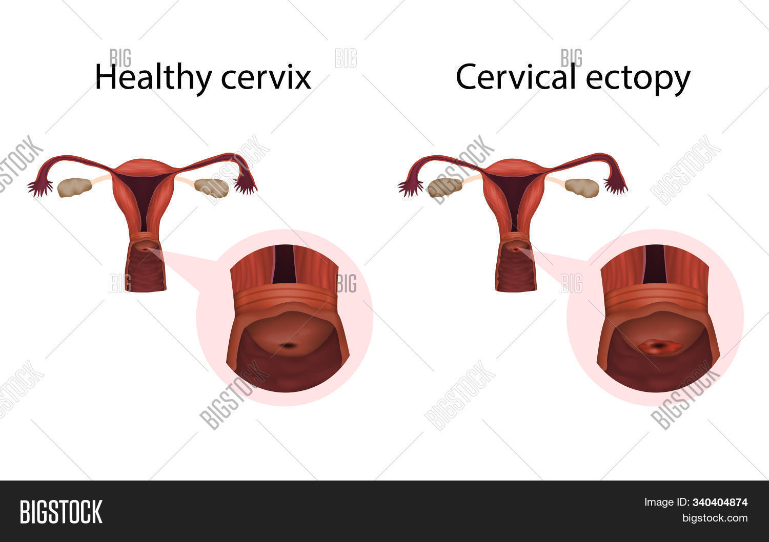 Cervix Ectopy Healthy Image & Photo (Free Trial) | Bigstock