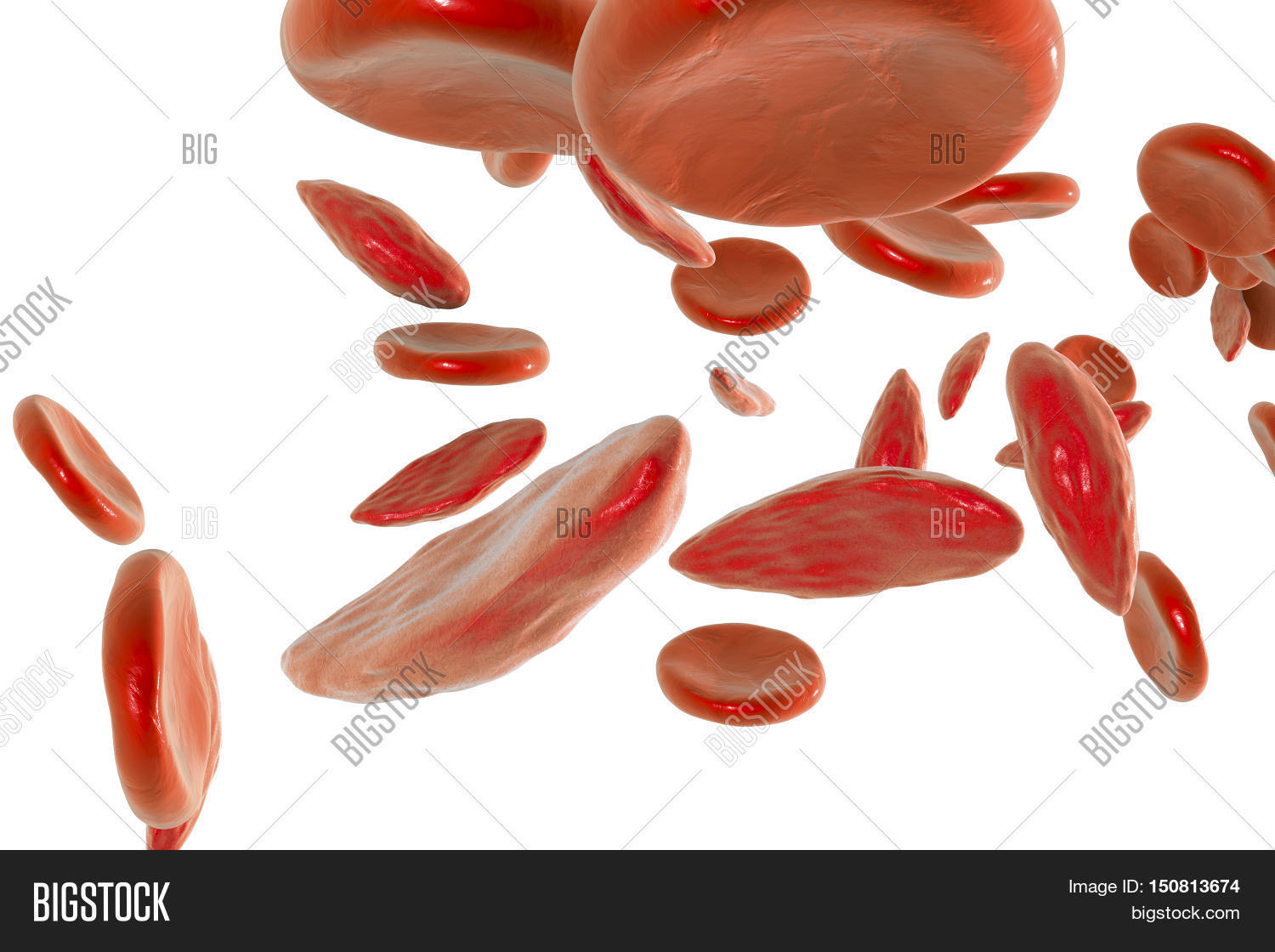 Sickle Cell Anemia, 3D Image & Photo (Free Trial) | Bigstock