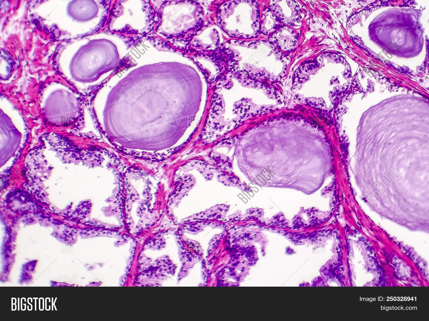 Benign Prostatic Image & Photo (Free Trial) | Bigstock