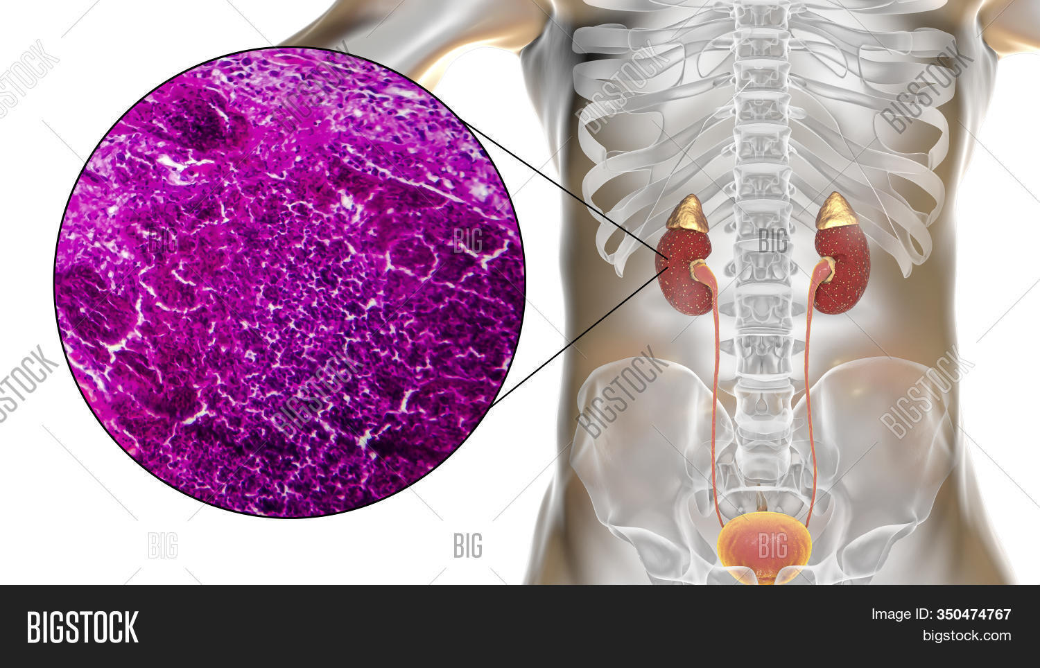 Acute Pyelonephritis, Image & Photo (Free Trial) | Bigstock