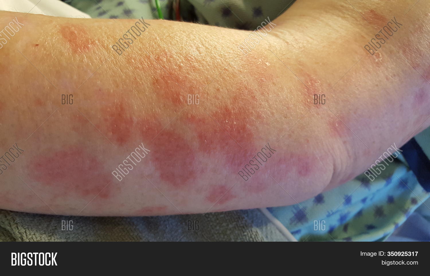 Erythema Multiforme Image & Photo (Free Trial) | Bigstock