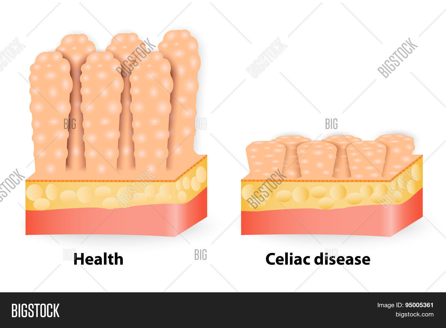 Coeliac Disease Vector & Photo (Free Trial) | Bigstock