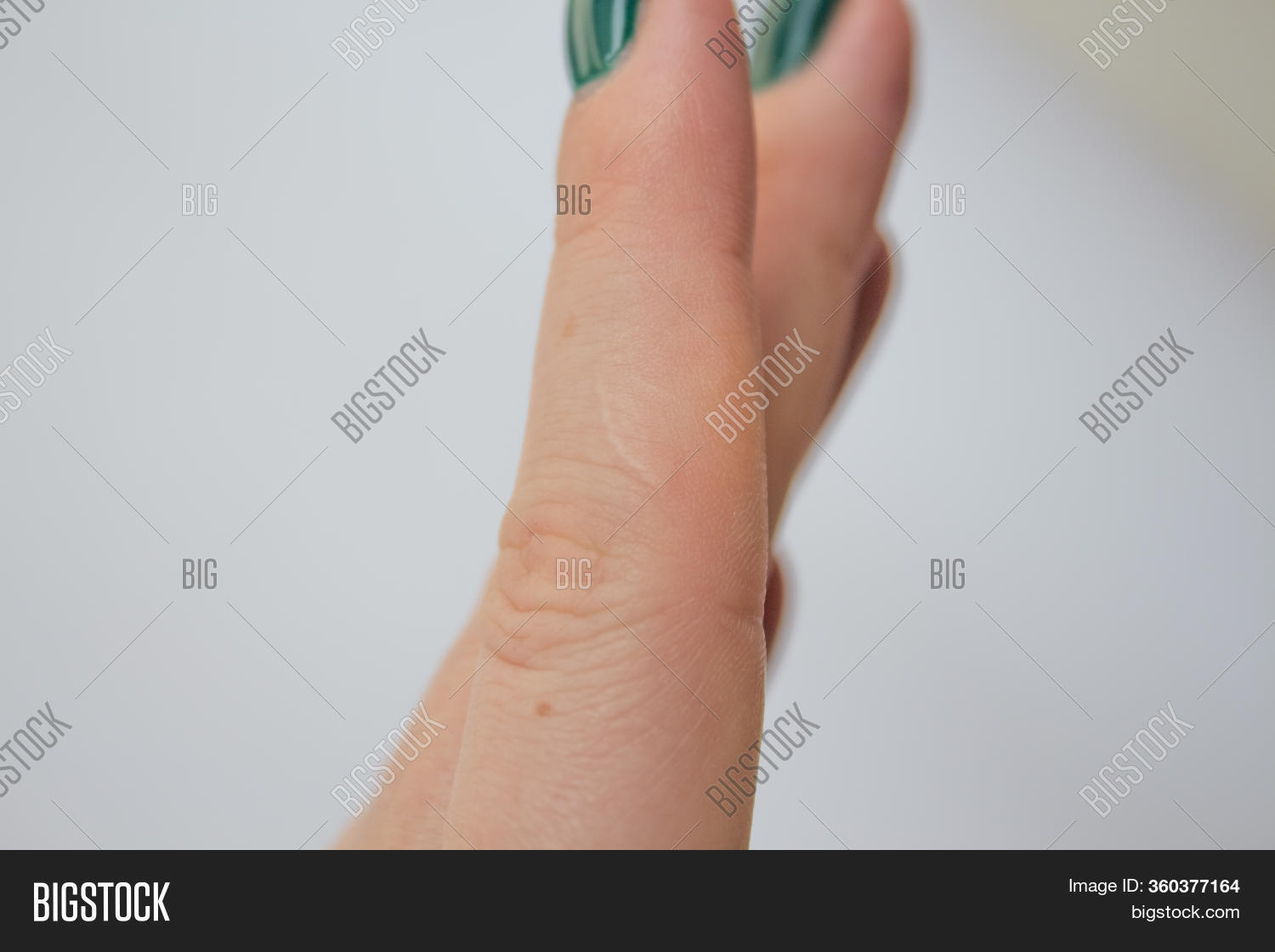 Scar On Finger Man On Image & Photo (Free Trial) | Bigstock