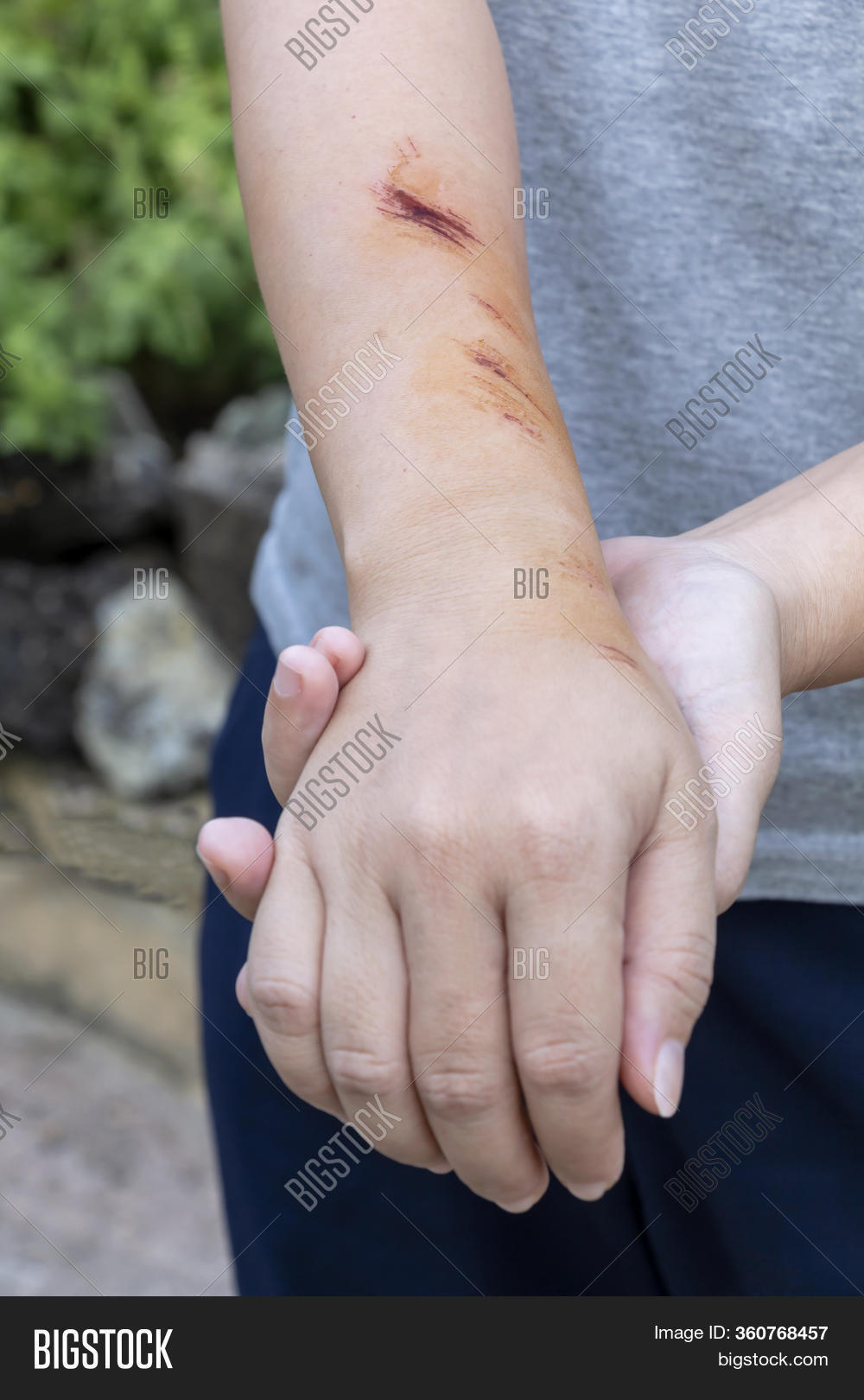 Wound Form Scabs On Image & Photo (Free Trial) | Bigstock