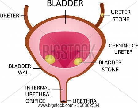 Stones Bladder. Two Vector & Photo (Free Trial) | Bigstock