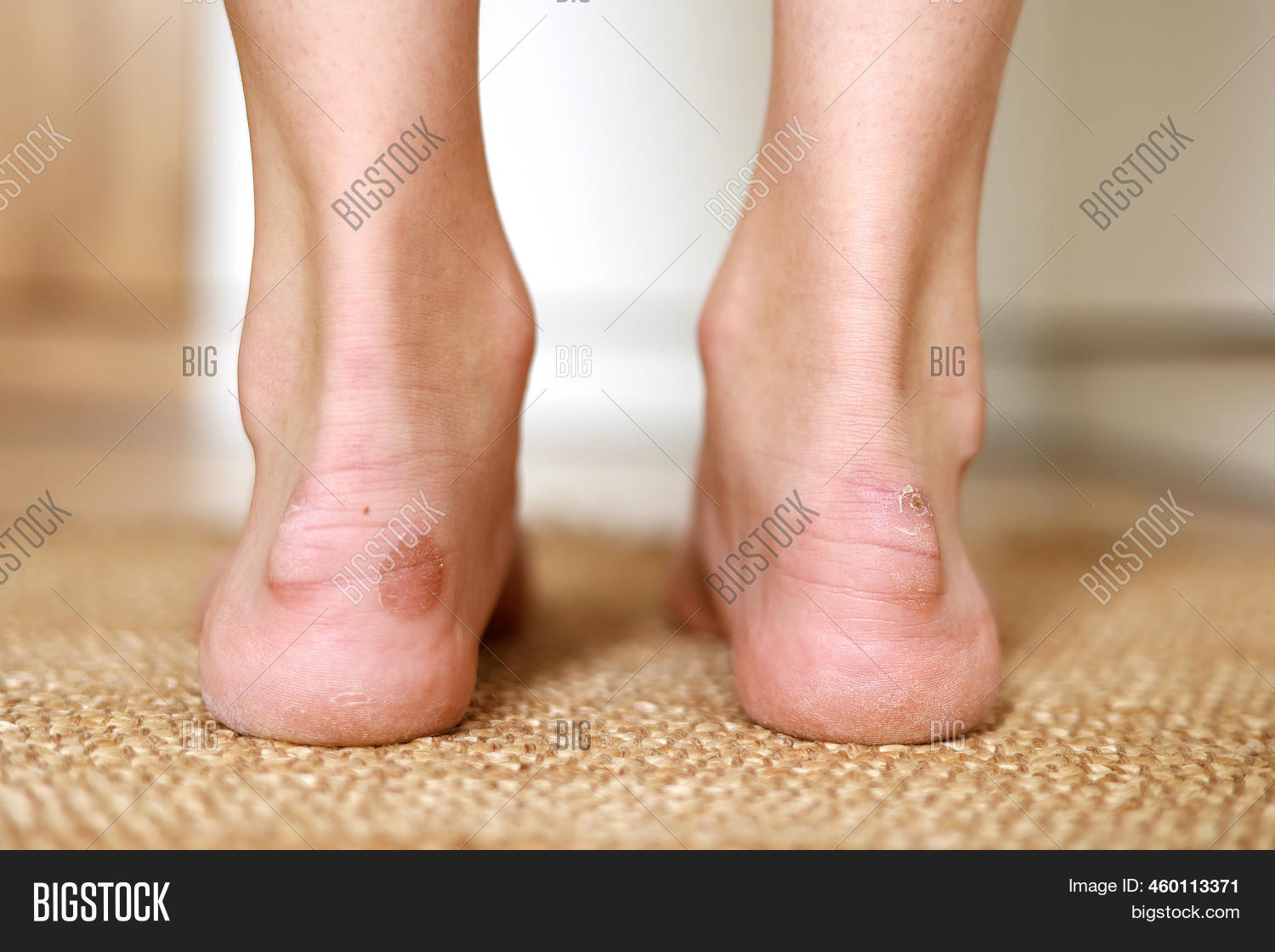 Callus Blisters On Image & Photo (Free Trial) | Bigstock