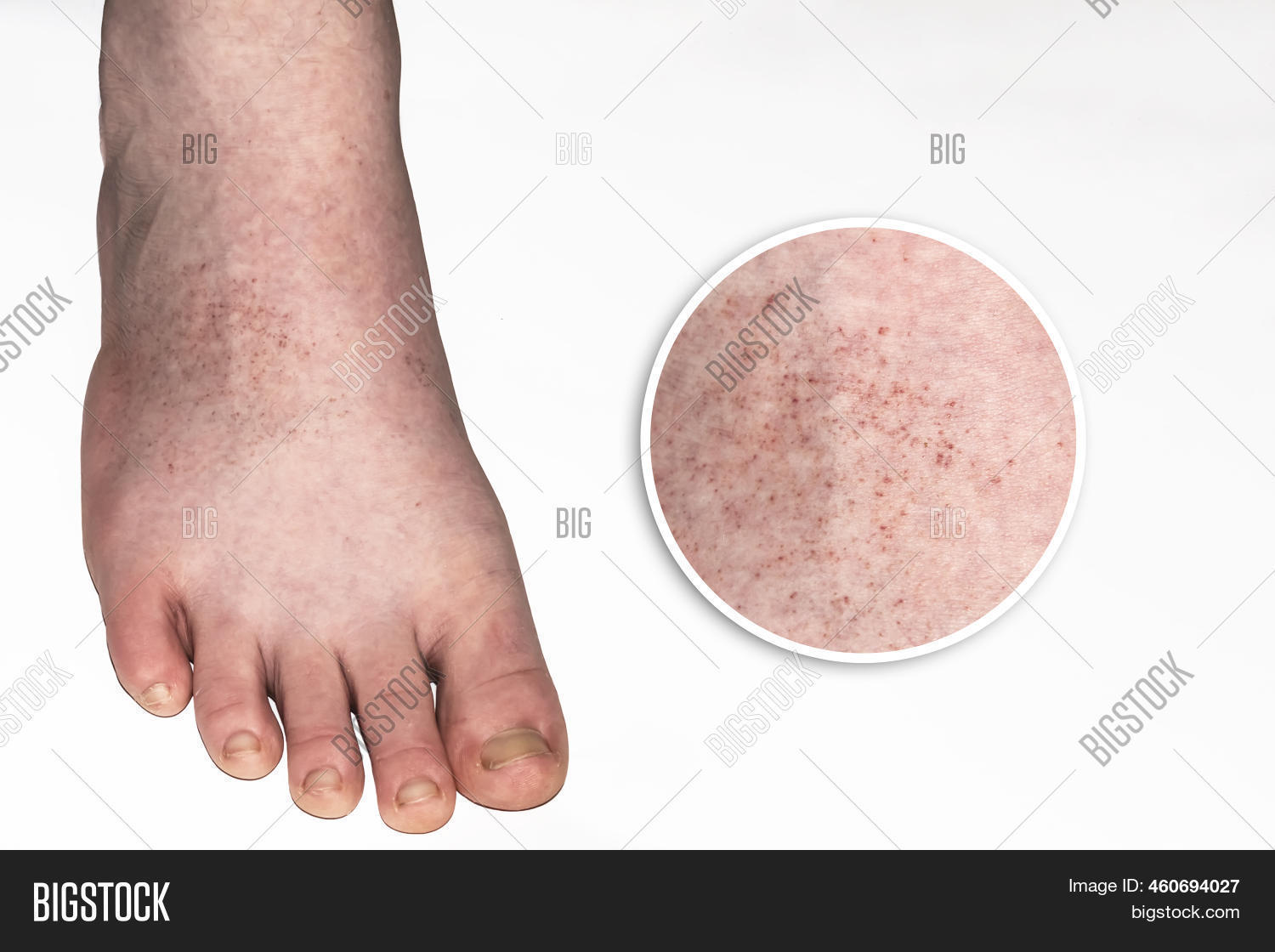 Red Rash On Foot Male Image & Photo (Free Trial) | Bigstock