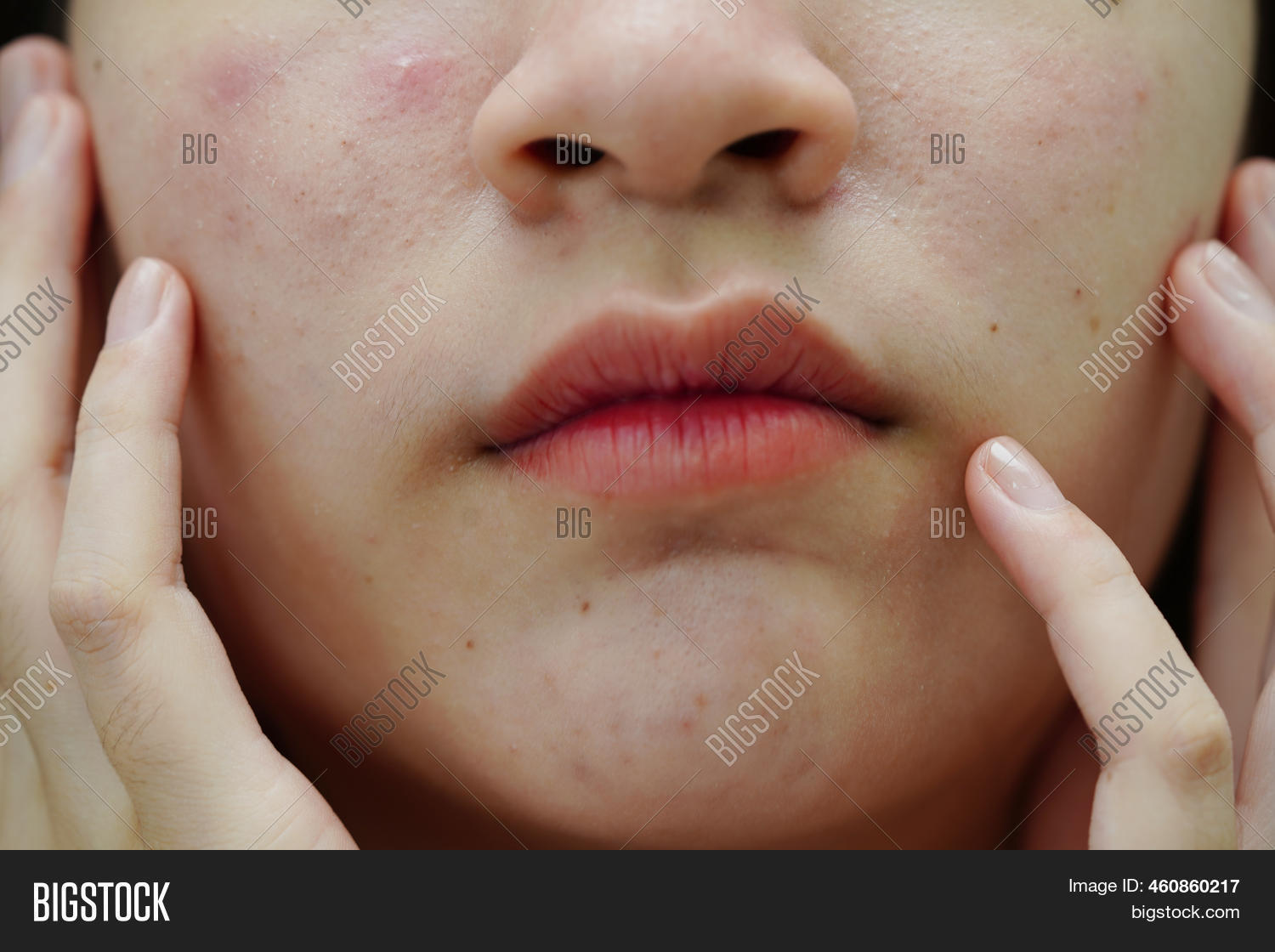 Acne Pimple Scar On Image & Photo (Free Trial) | Bigstock