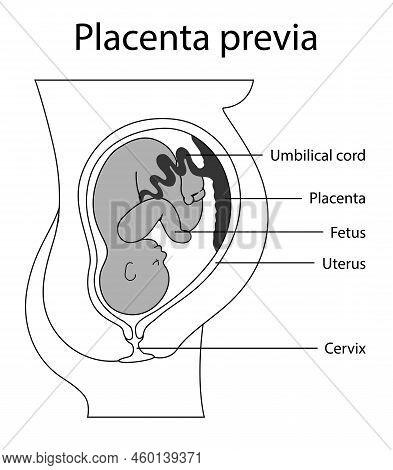 Placental Previa. Vector & Photo (Free Trial) | Bigstock