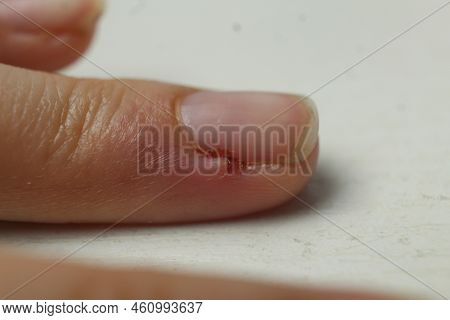 Damaged Burr On Finger Image & Photo (Free Trial) | Bigstock