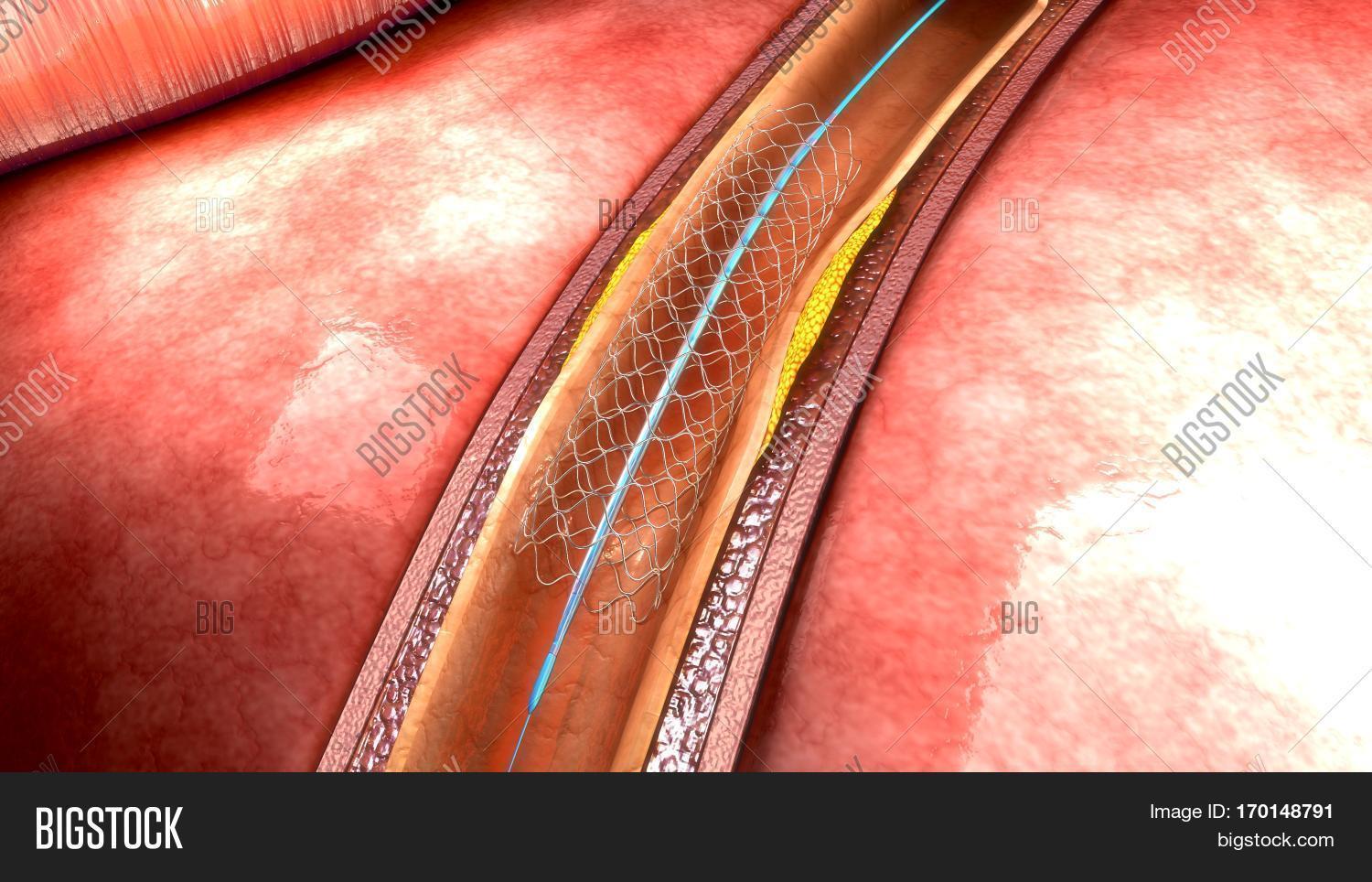 Stent Tiny Tube That Image & Photo (Free Trial) | Bigstock