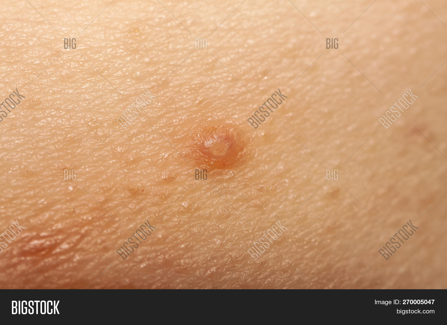 Close Molluscum Image & Photo (Free Trial) | Bigstock
