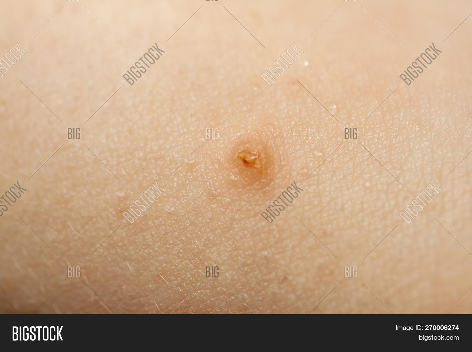 Close Molluscum Image & Photo (Free Trial) | Bigstock