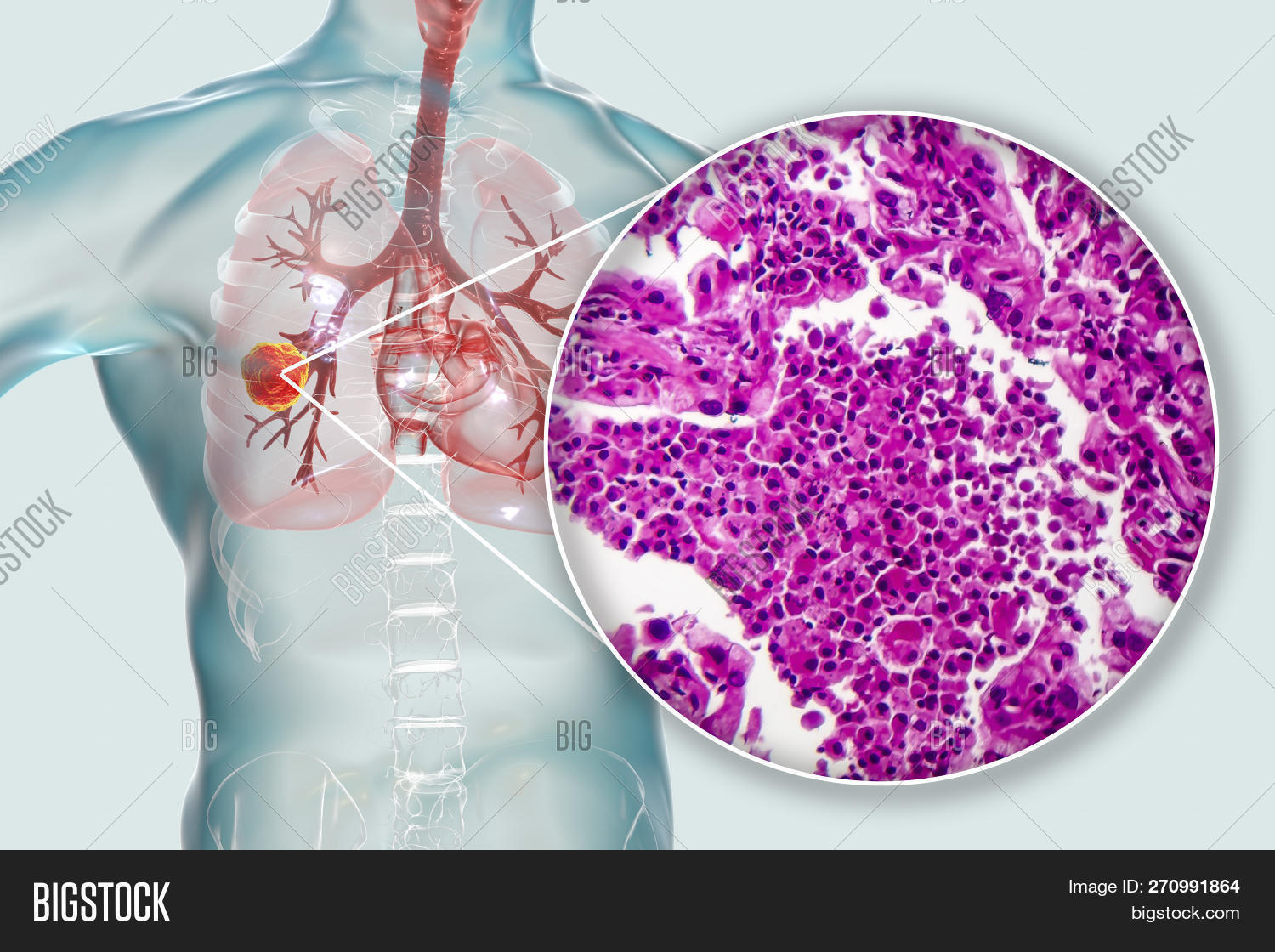 Lung Cancer, 3d Image & Photo (Free Trial) | Bigstock