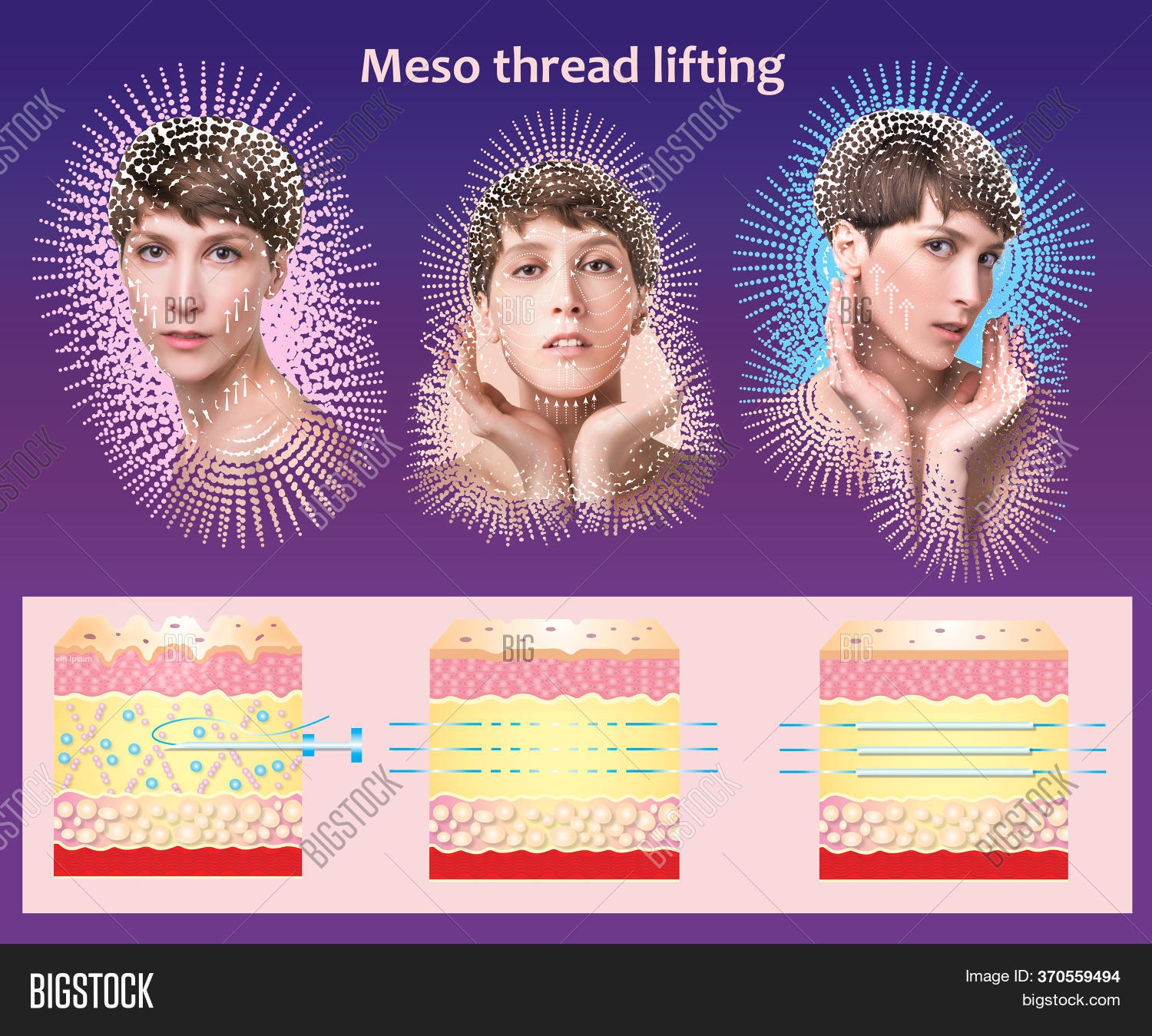 Meso Thread Lift. Image & Photo (Free Trial) | Bigstock