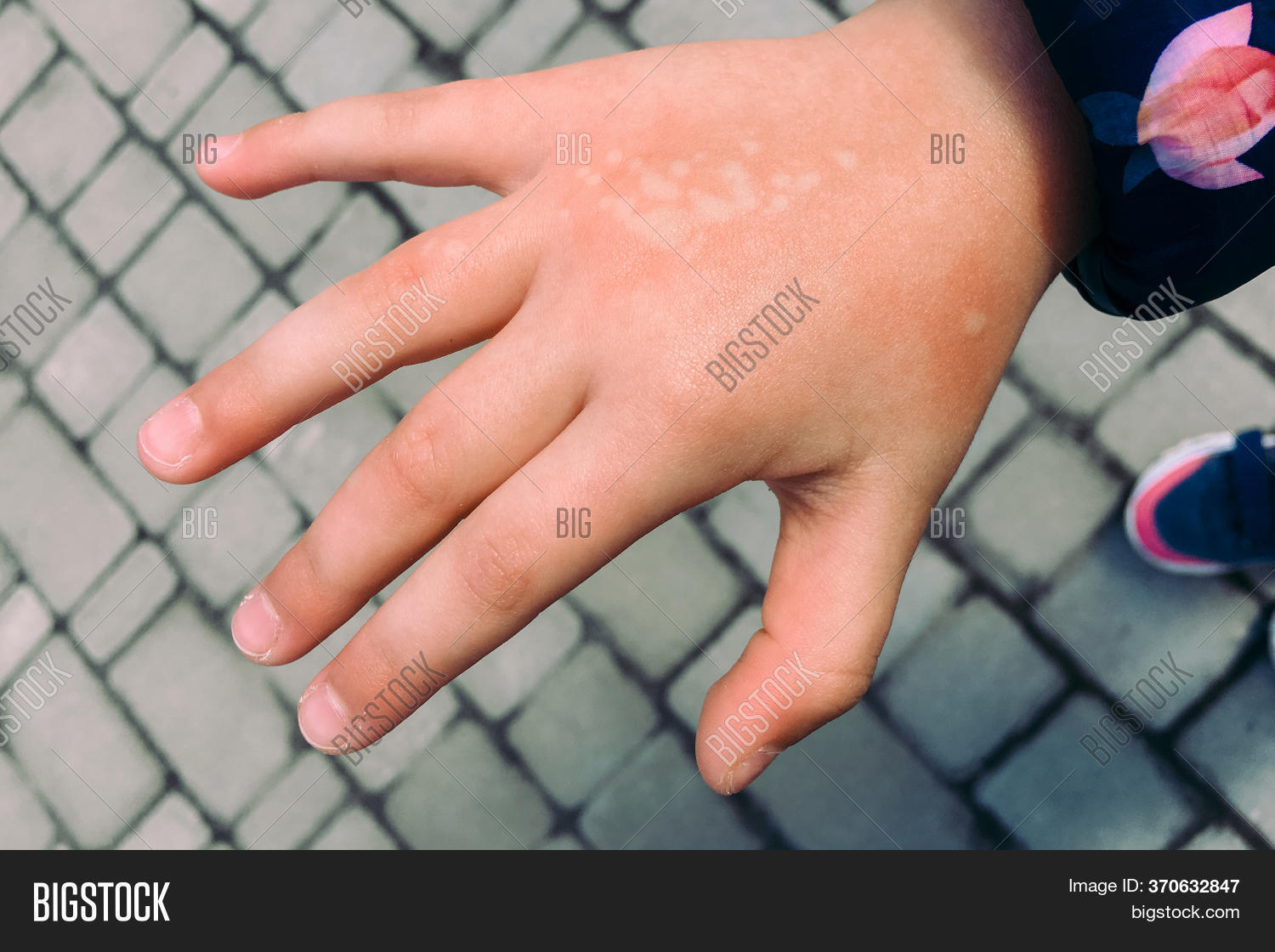 Girl Burned Her Hand Image & Photo (Free Trial) | Bigstock