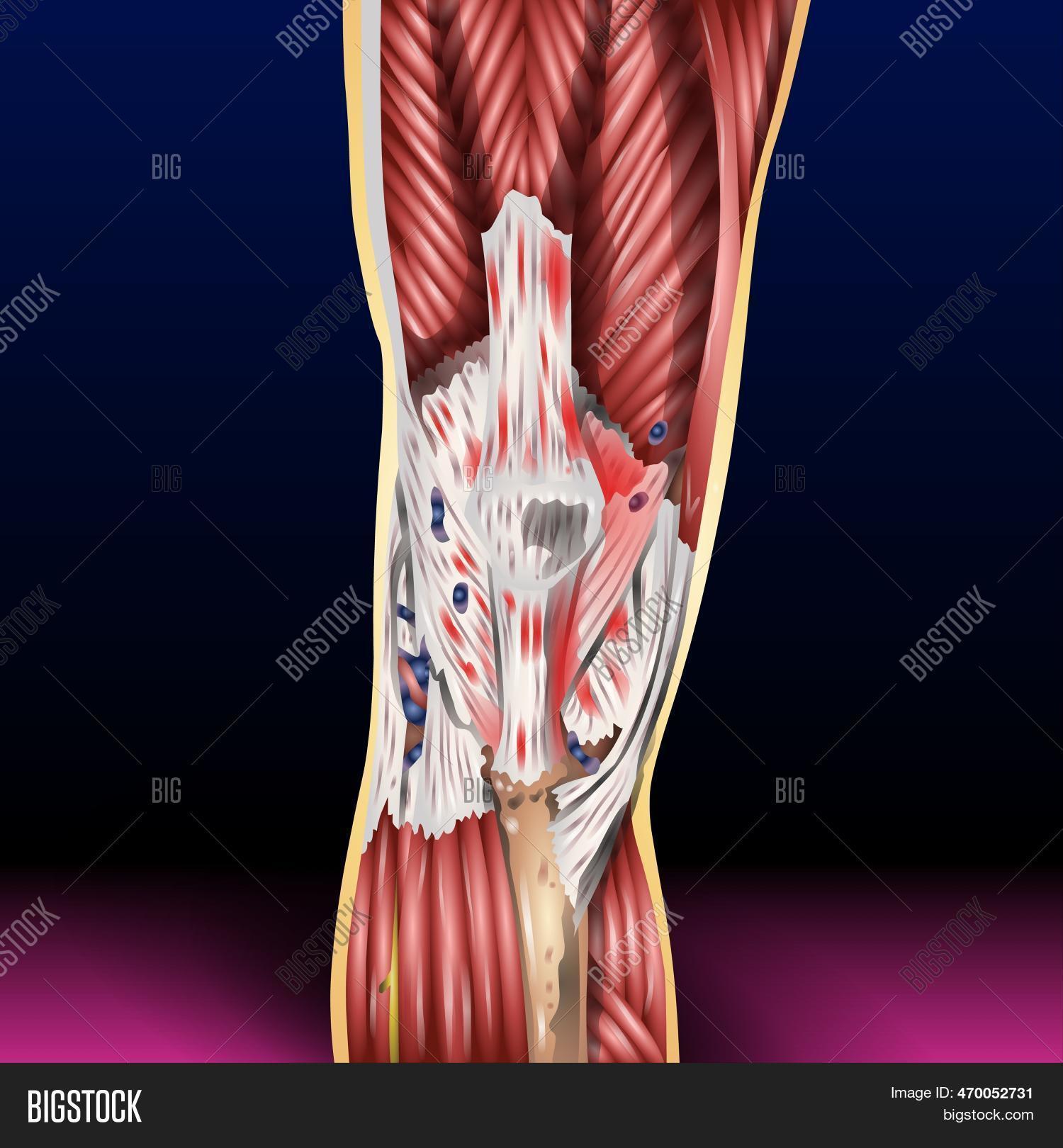 Tendinitis Leg - Image & Photo (Free Trial) | Bigstock