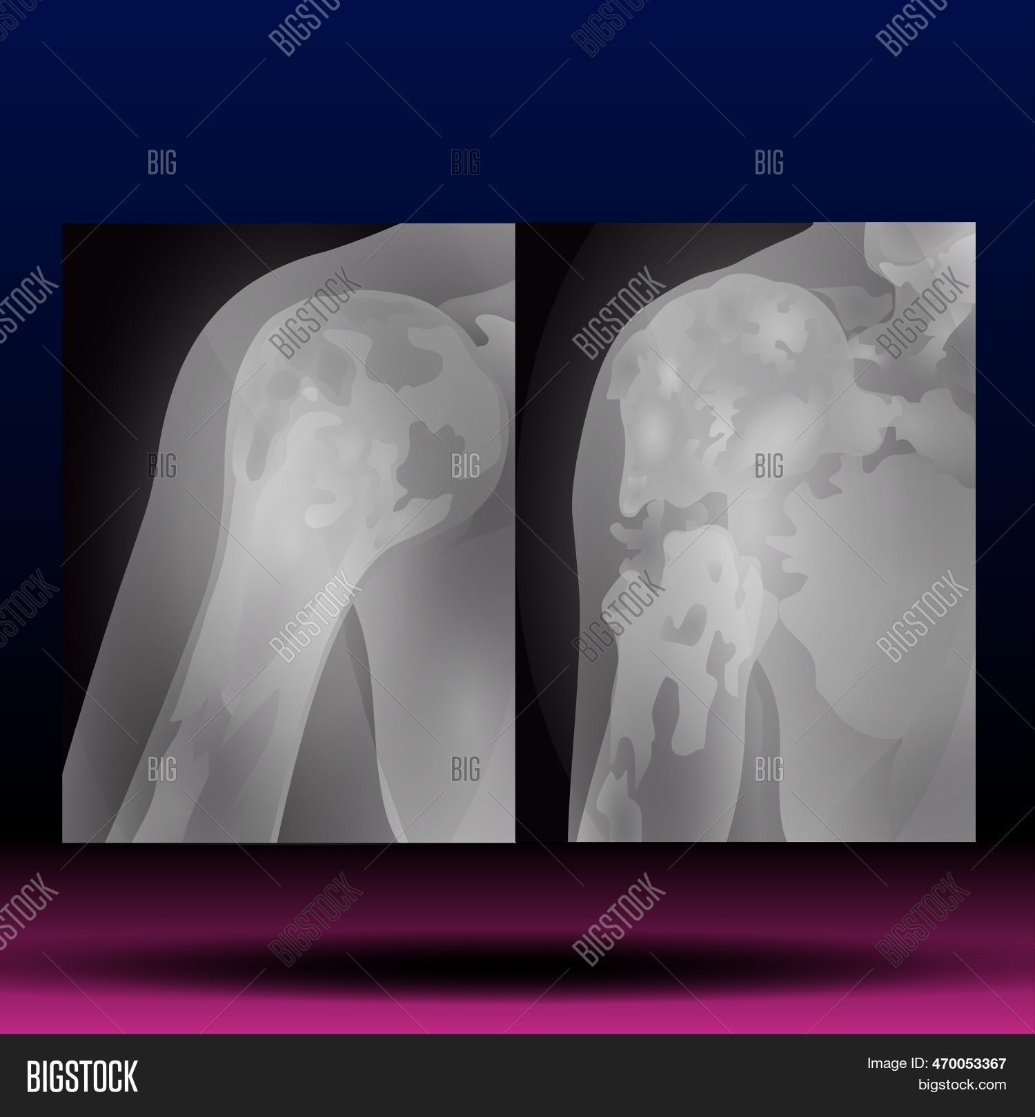 X Ray Shoulder Anatomy