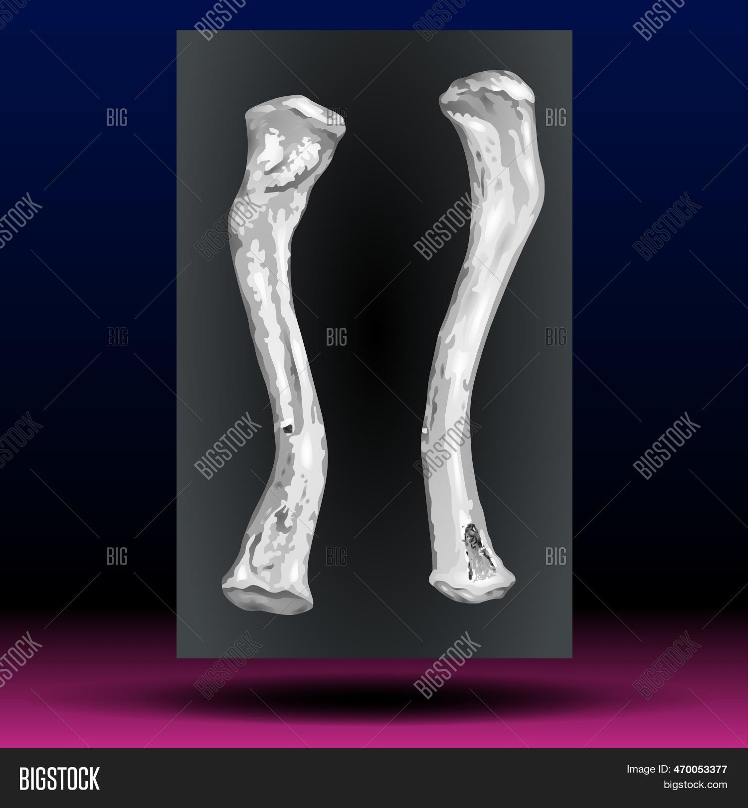 X-ray Shoulder Bone - Image & Photo (Free Trial) | Bigstock