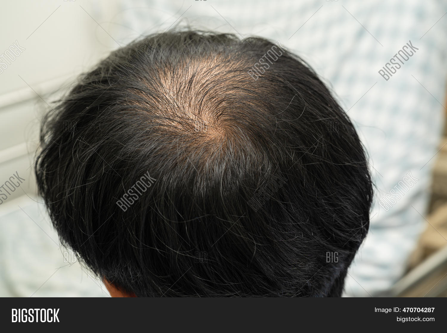 Bald Middle Head Begin Image & Photo (Free Trial) | Bigstock