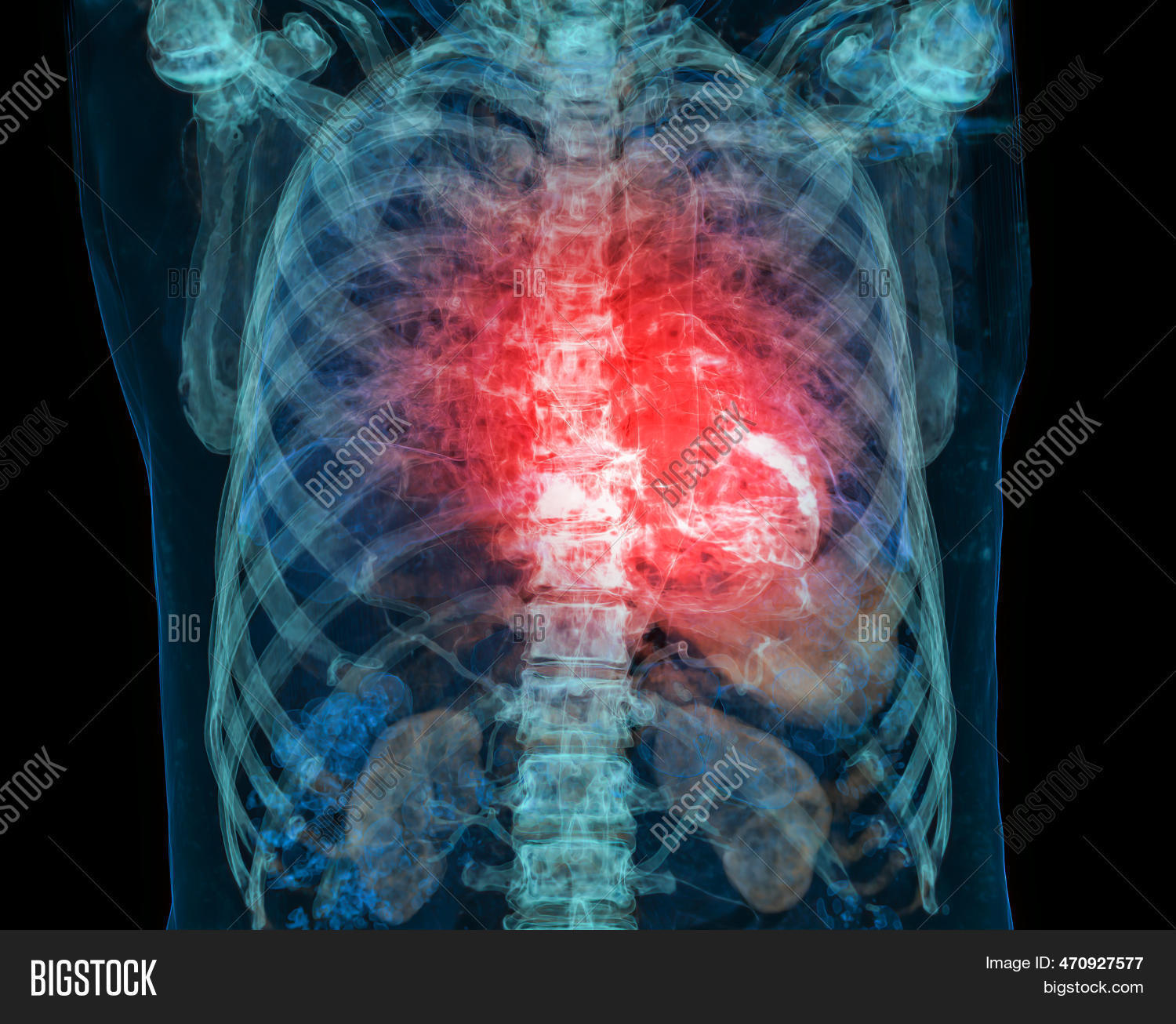 Imagen y foto Human Heart Attack (prueba gratis) | Bigstock