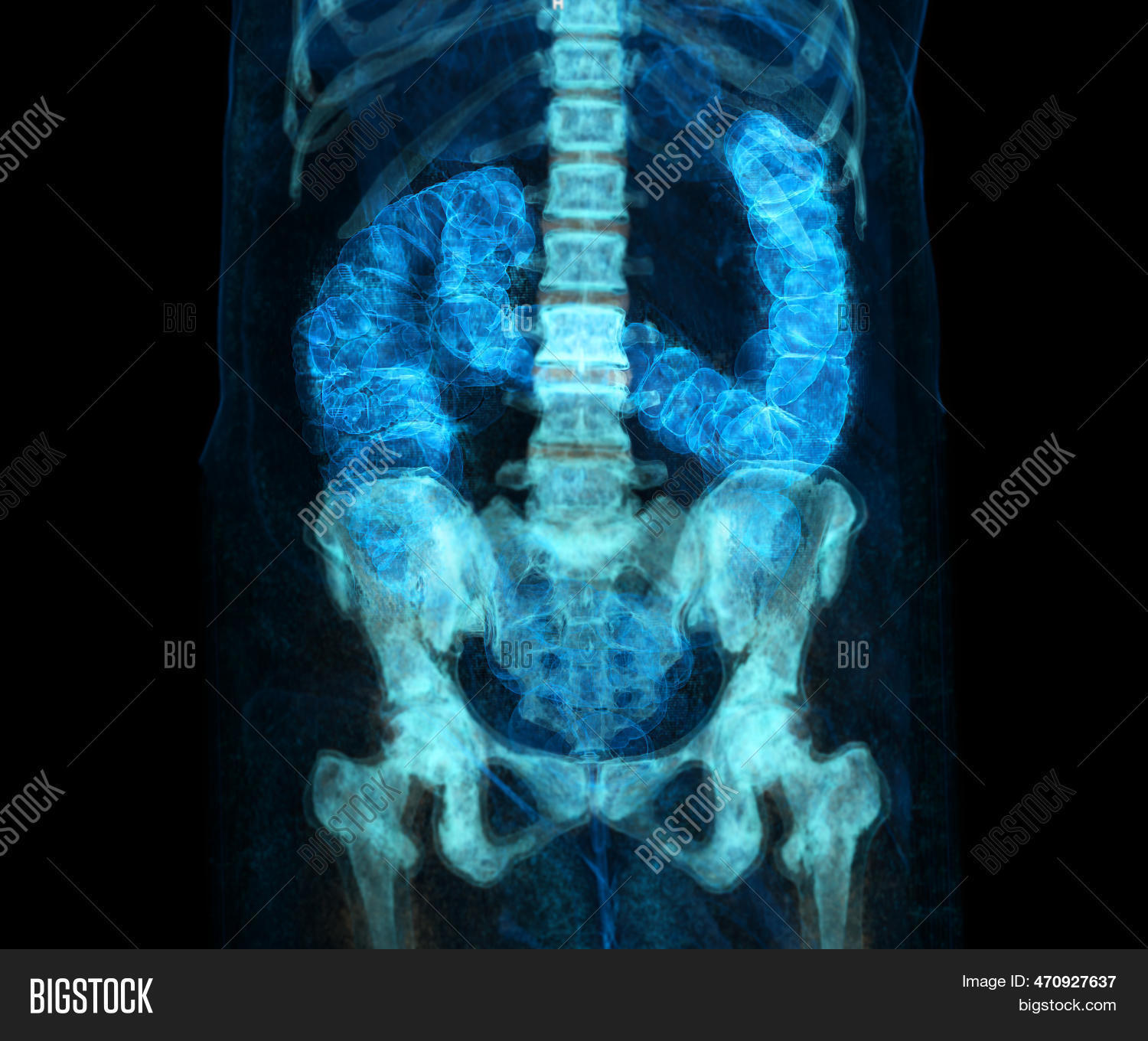 Ct Colonography Ct Image & Photo (Free Trial) | Bigstock