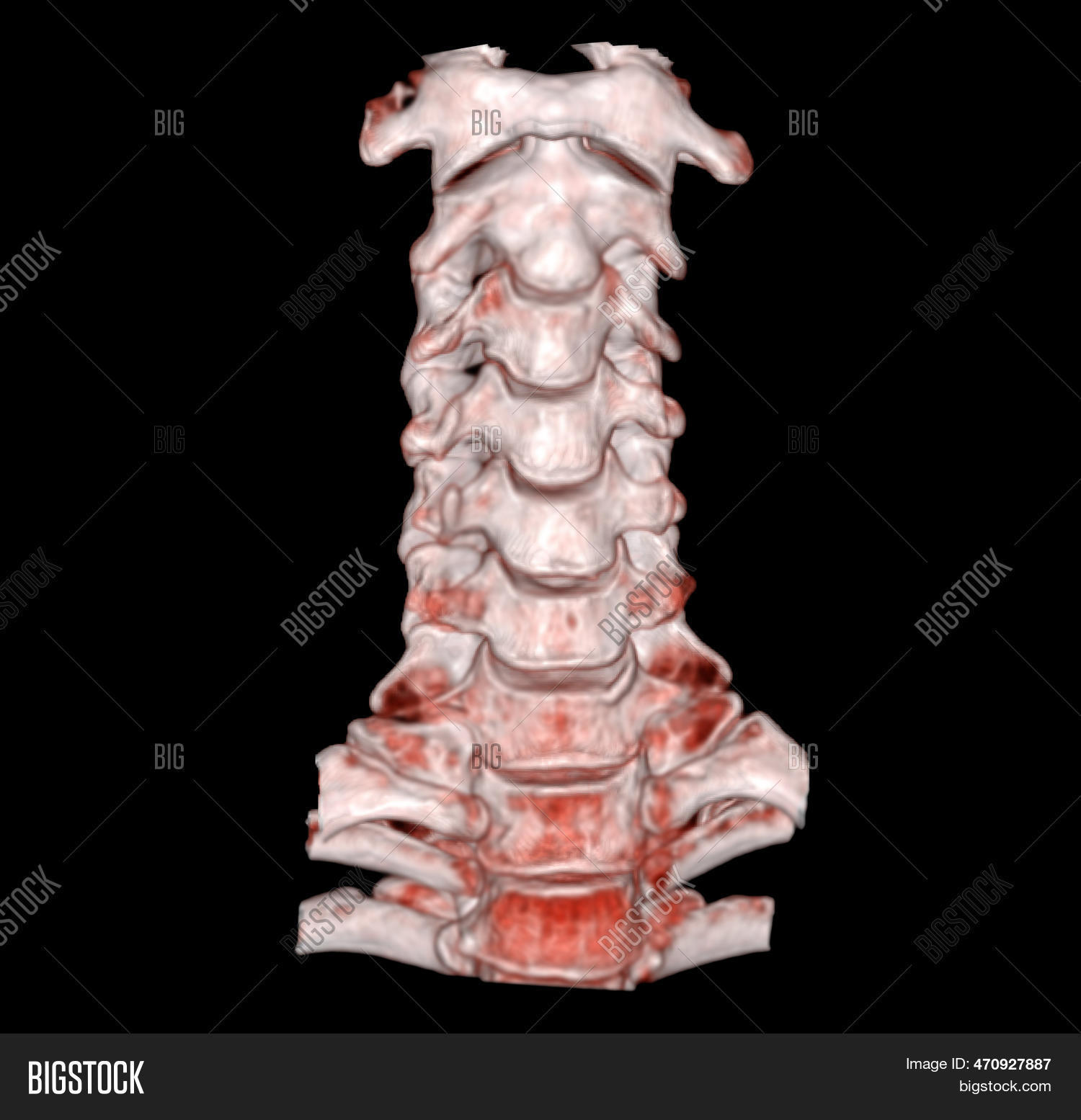 Ct Scan Cervical Spine Image & Photo (Free Trial) | Bigstock