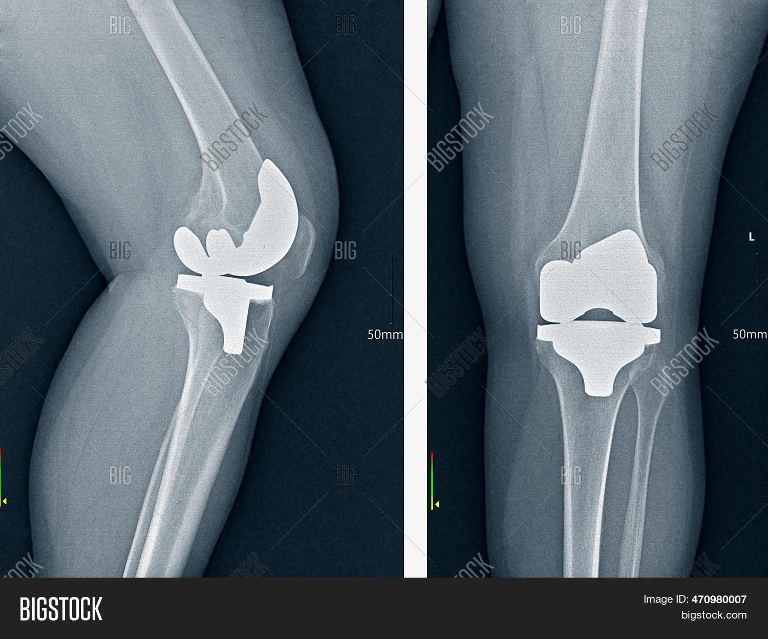 X-ray Left Knee Joint Image & Photo (Free Trial) | Bigstock